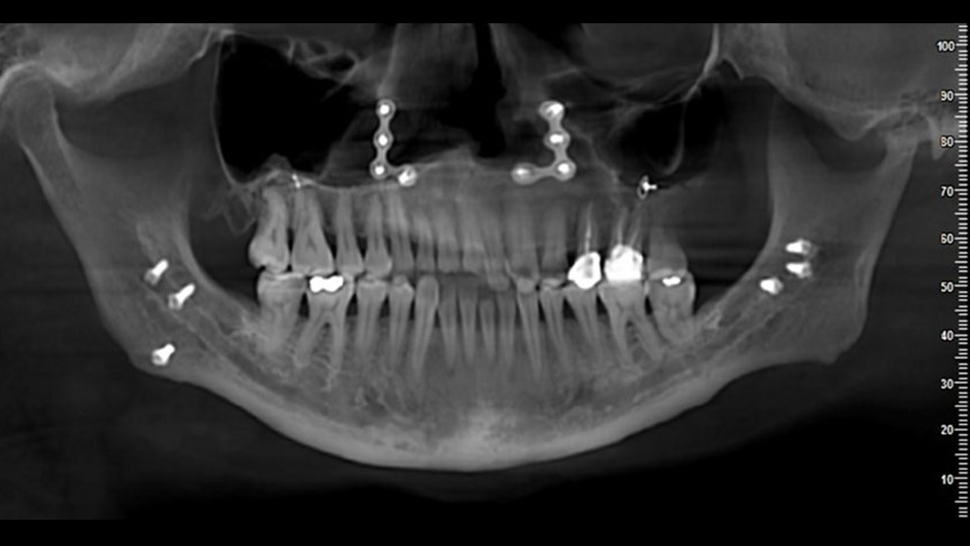 DT News - Italy - Allineatori trasparenti in tecnica Invisalign ...
