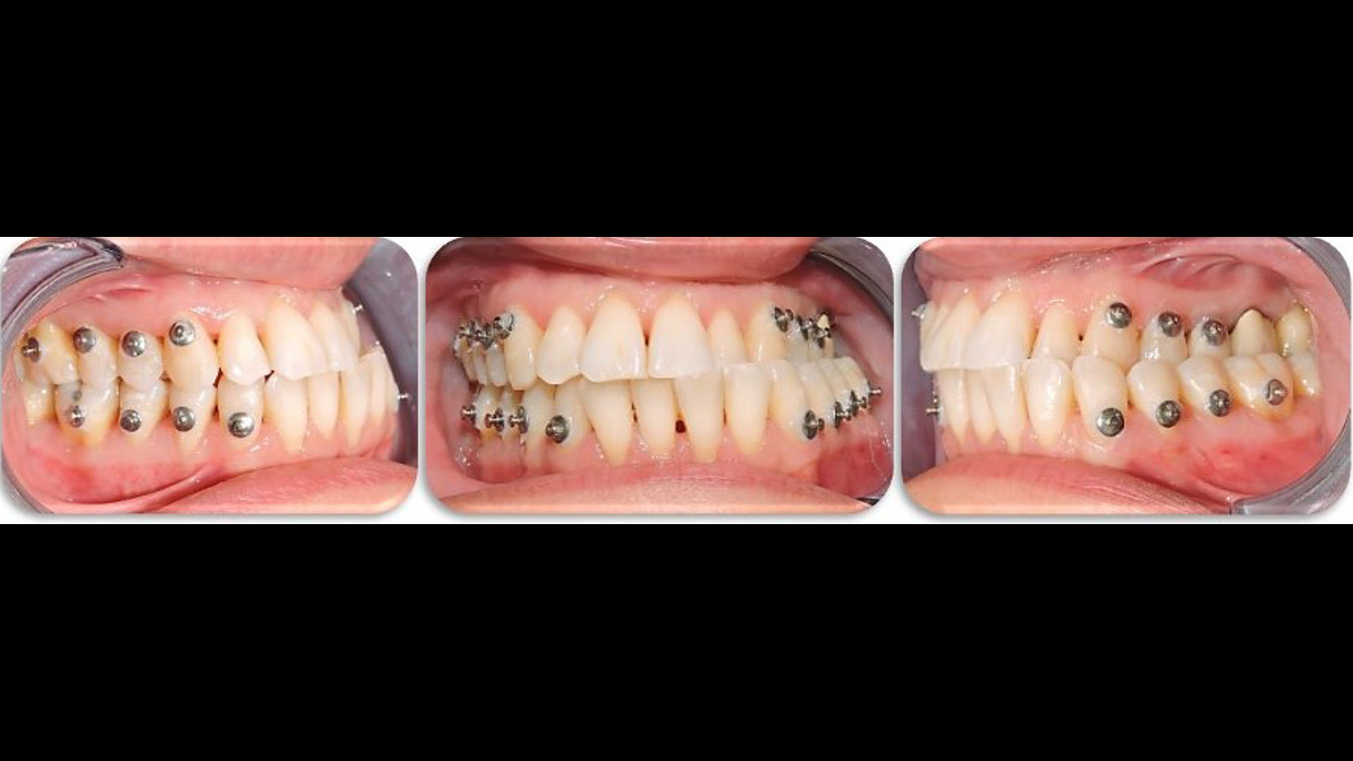 DT News - Italy - Allineatori trasparenti in tecnica Invisalign ...