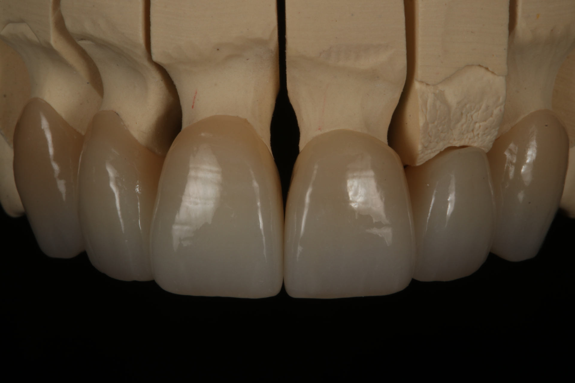 The zirconia dream team: Effect liquids and micro-layering