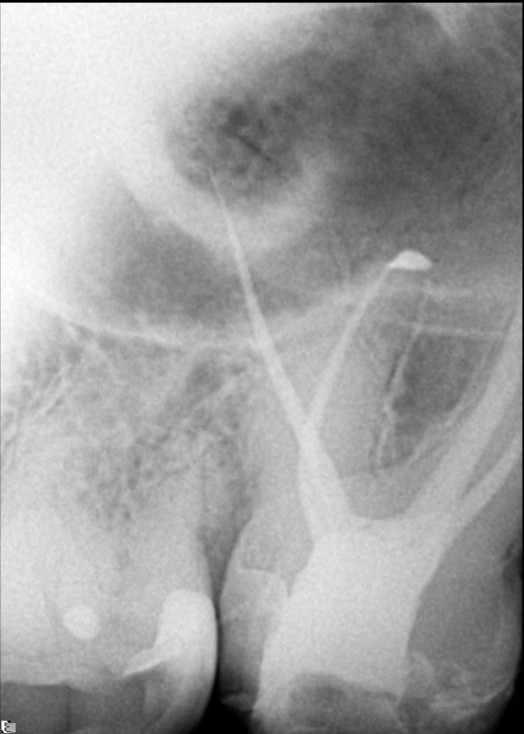 Using digital software for effective root canal therapy