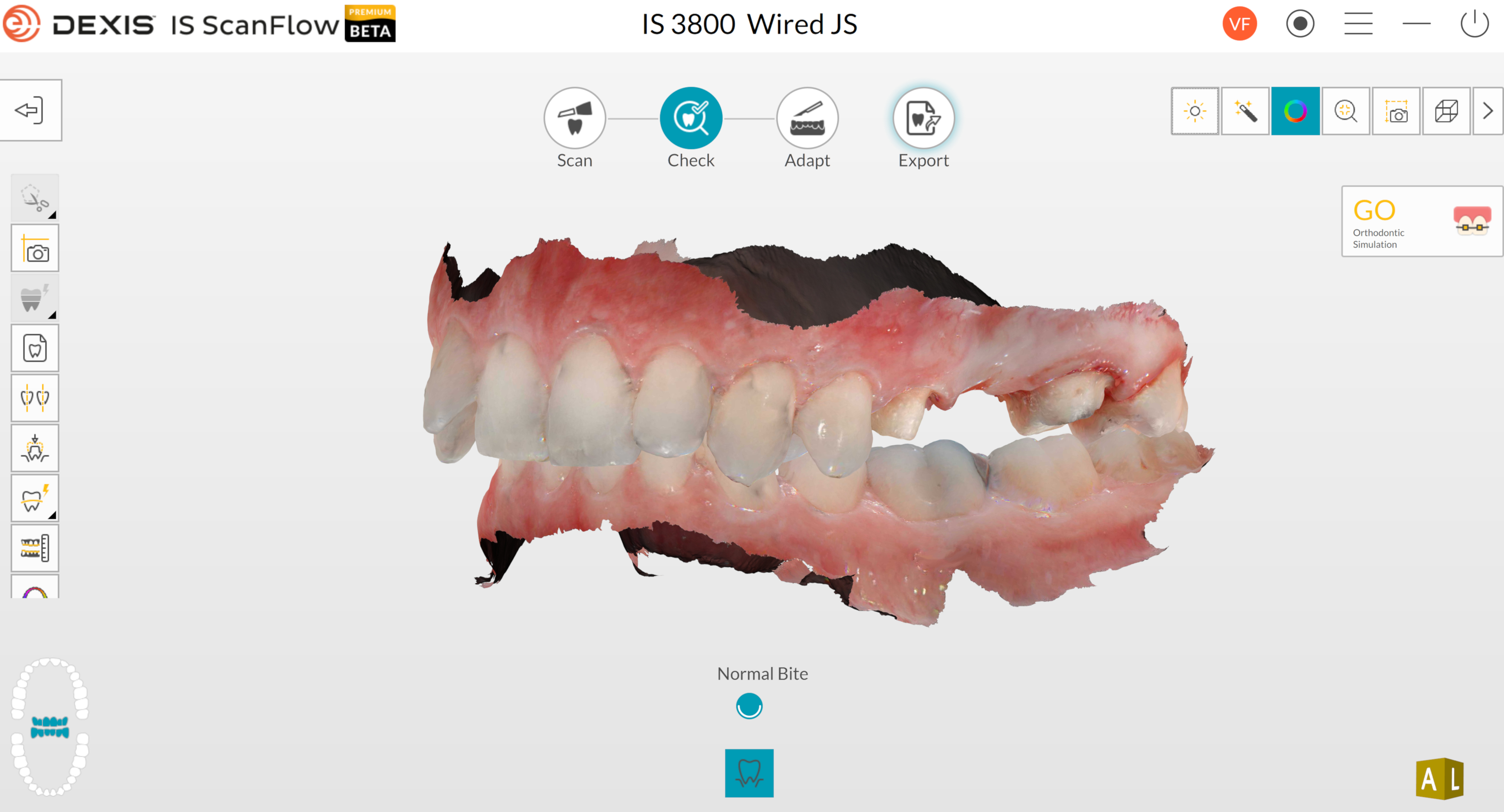 A three-unit bridge restoration of a fractured ceramic crown