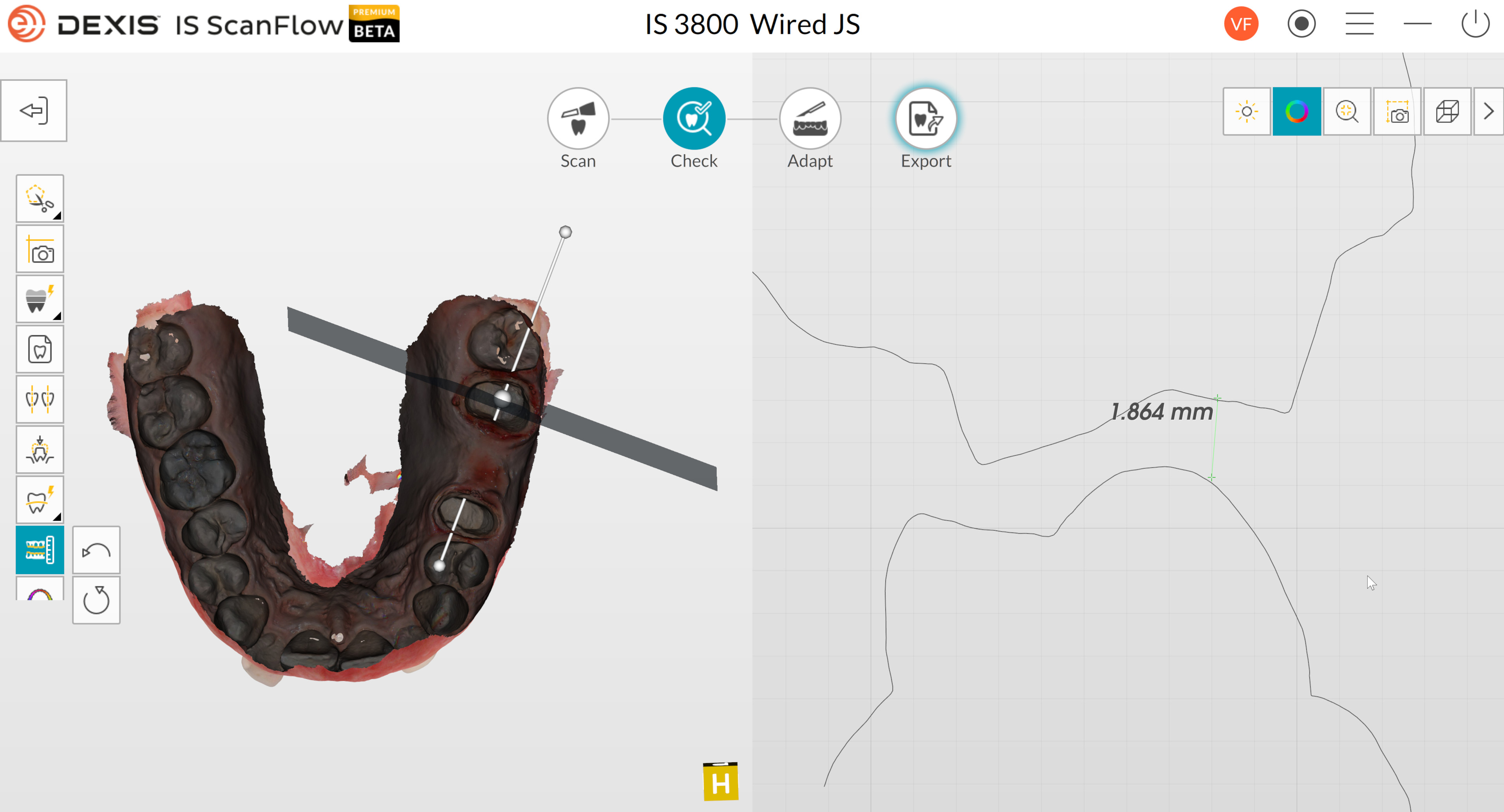 A three-unit bridge restoration of a fractured ceramic crown