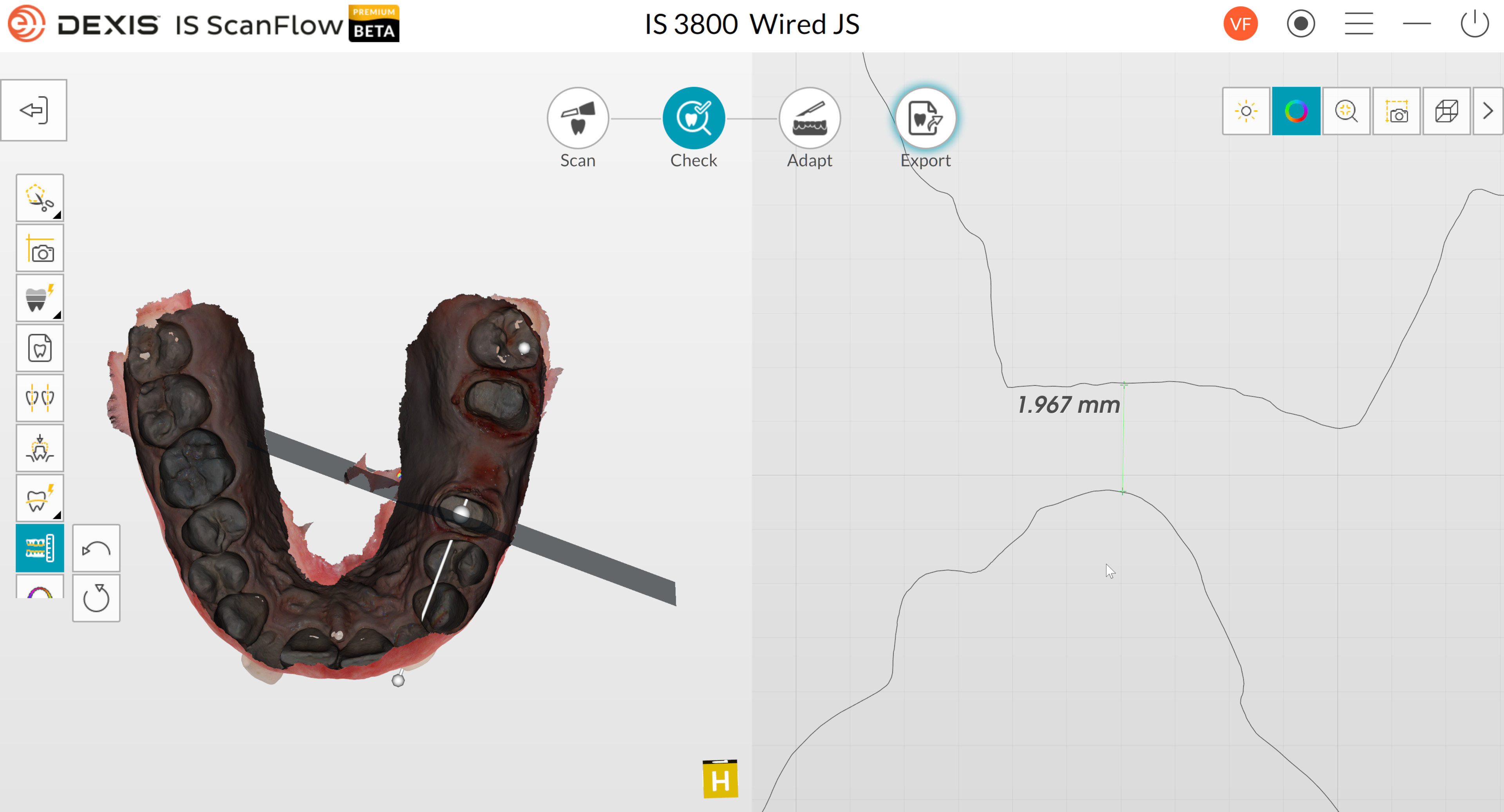 A three-unit bridge restoration of a fractured ceramic crown