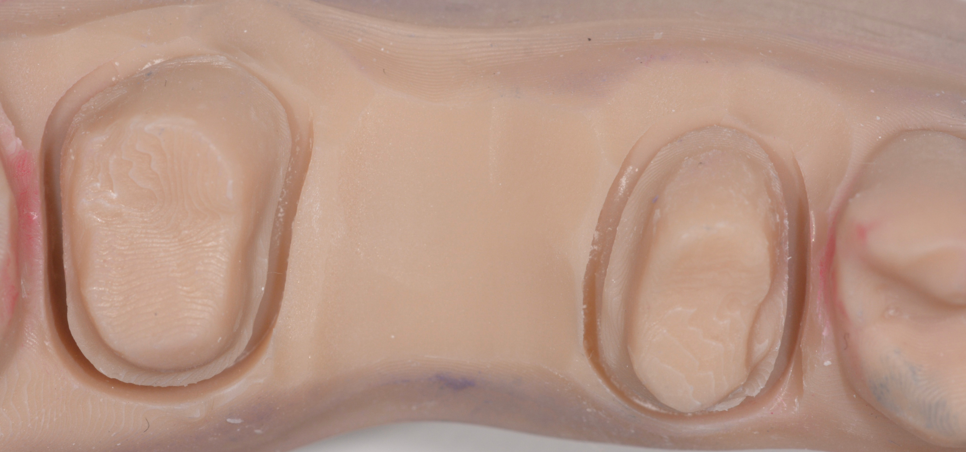 A three-unit bridge restoration of a fractured ceramic crown