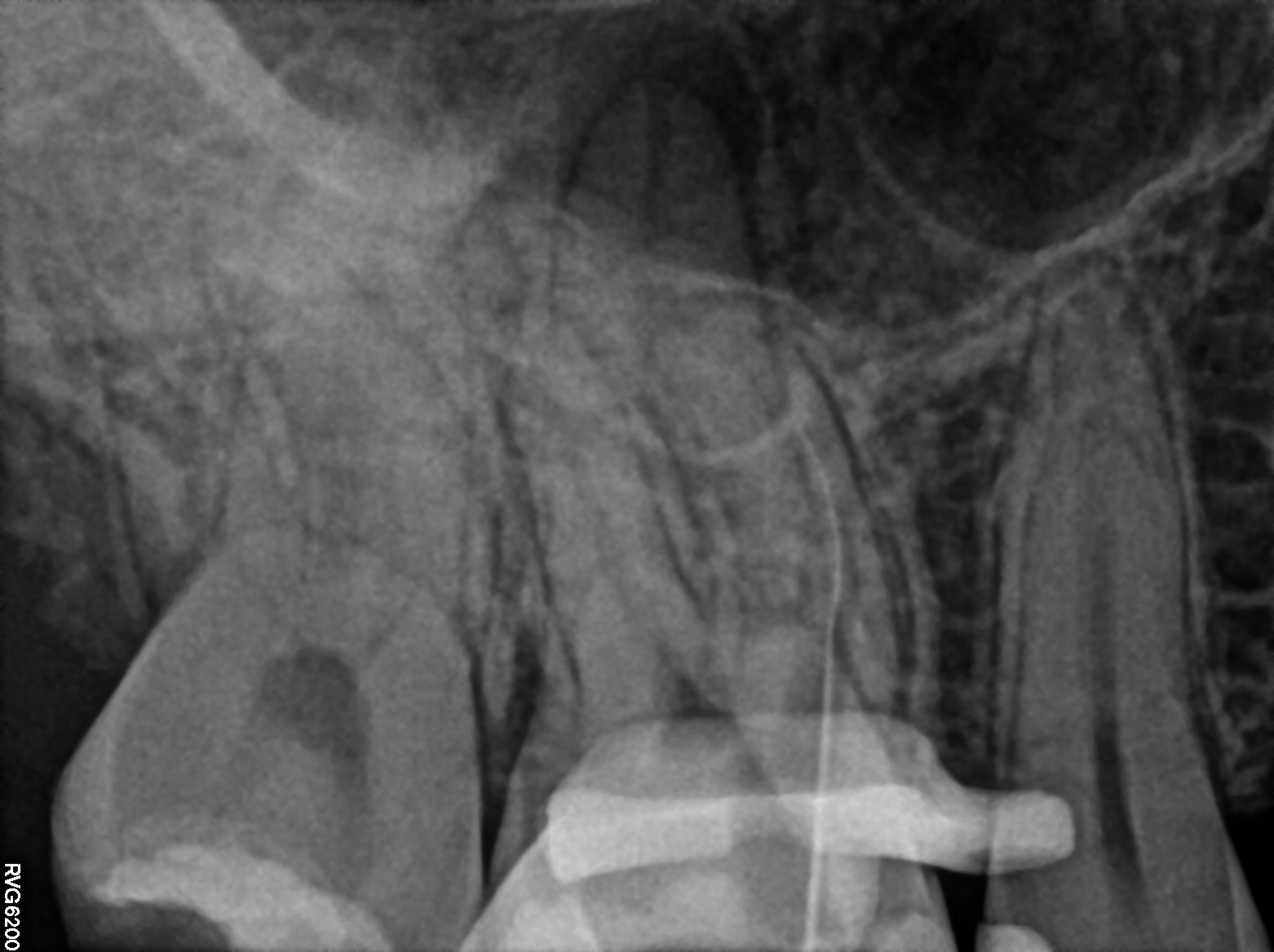 Management of complex endodontic cases