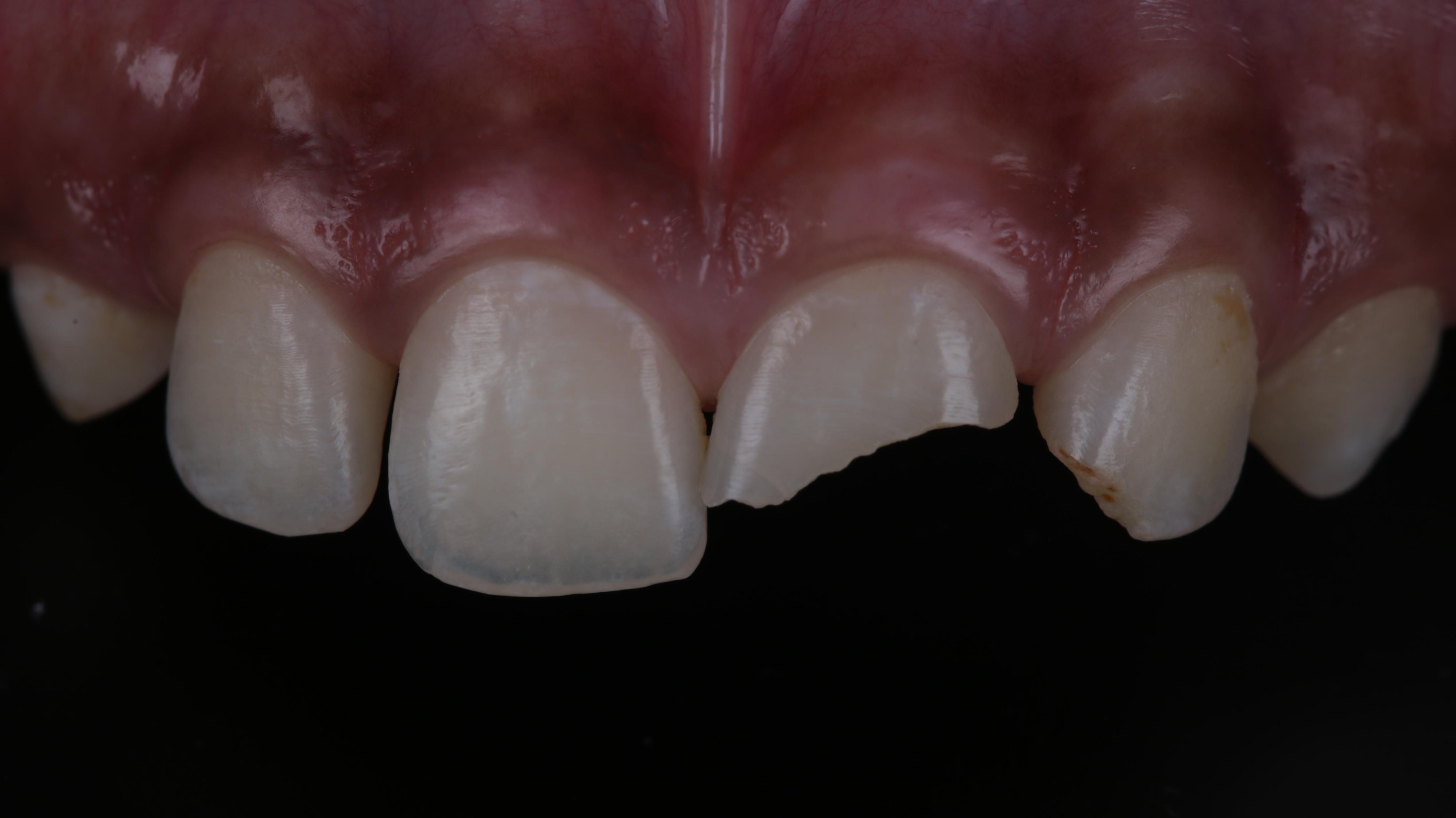 DT News - India - Polychromatic Layering Technique (PLT)—full protocol ...