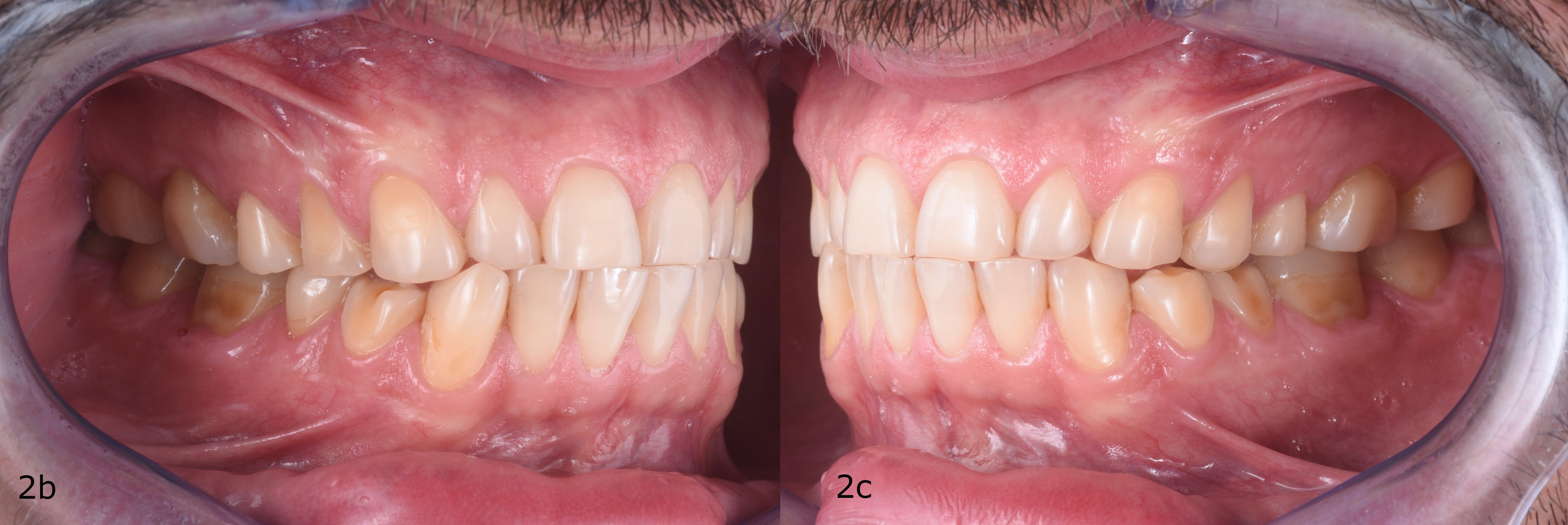 An aesthetic, minimally invasive restoration