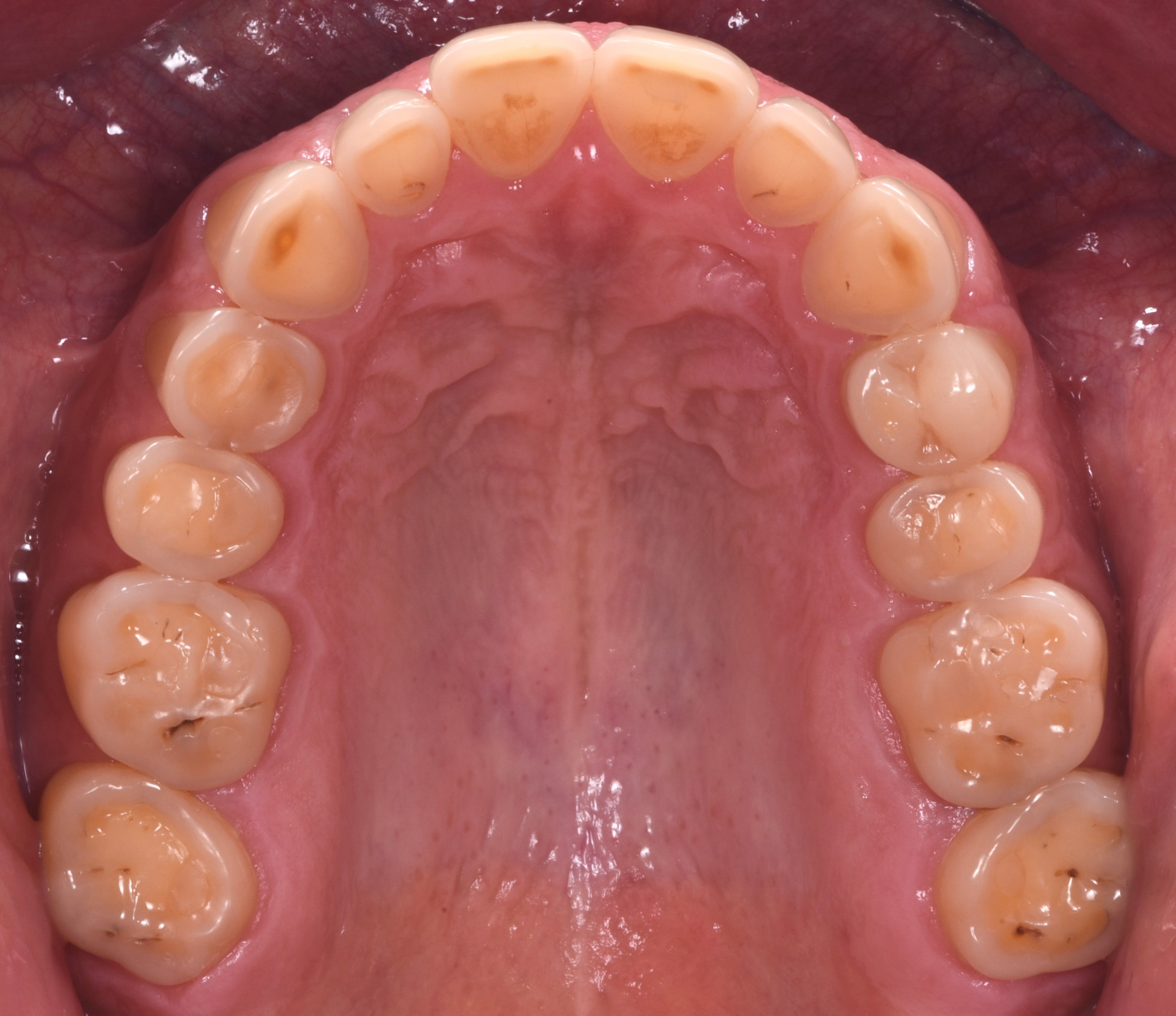 An aesthetic, minimally invasive restoration