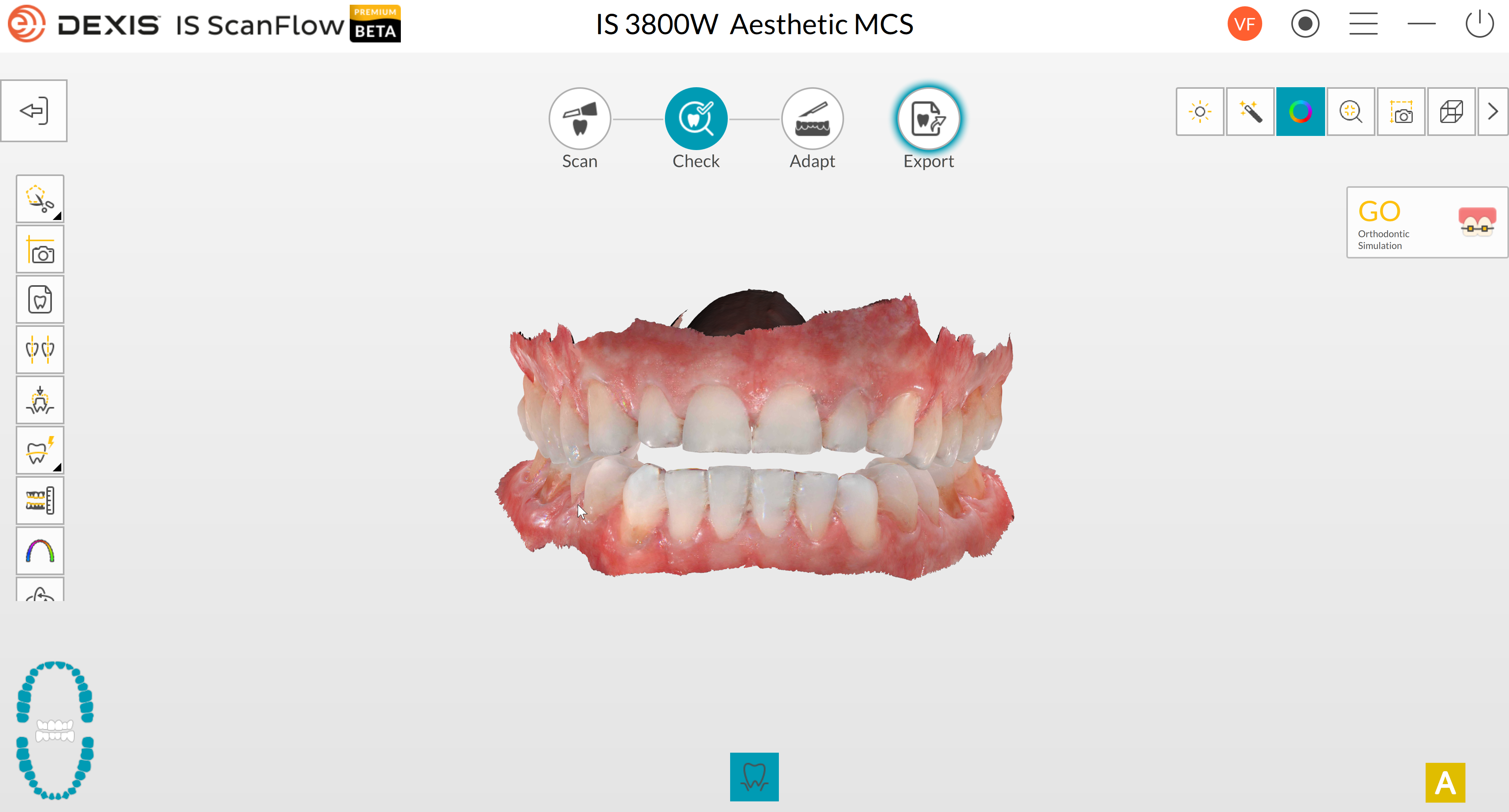 An aesthetic, minimally invasive restoration