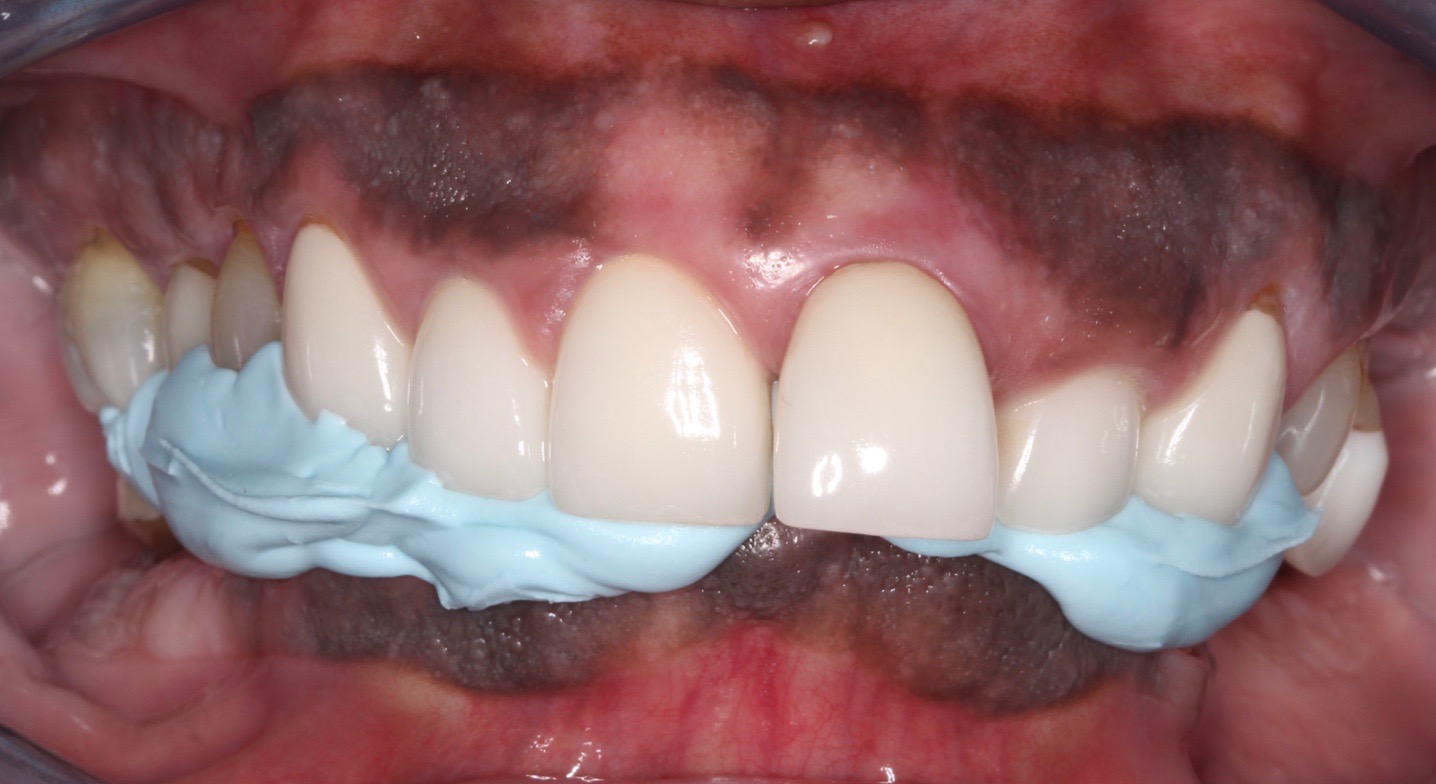 Predictable aesthetic success with a digital workflow