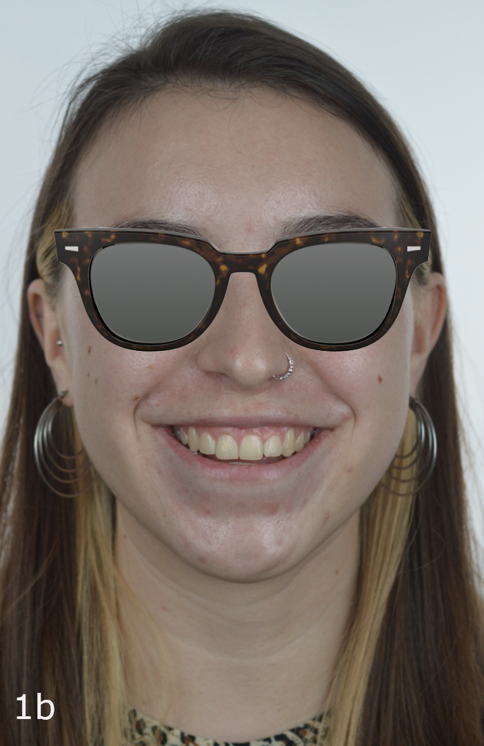 Class III malocclusion treated with clear aligners