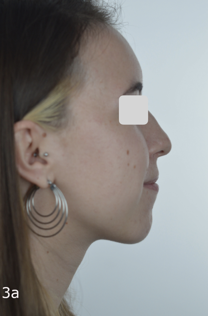 Class III malocclusion treated with clear aligners