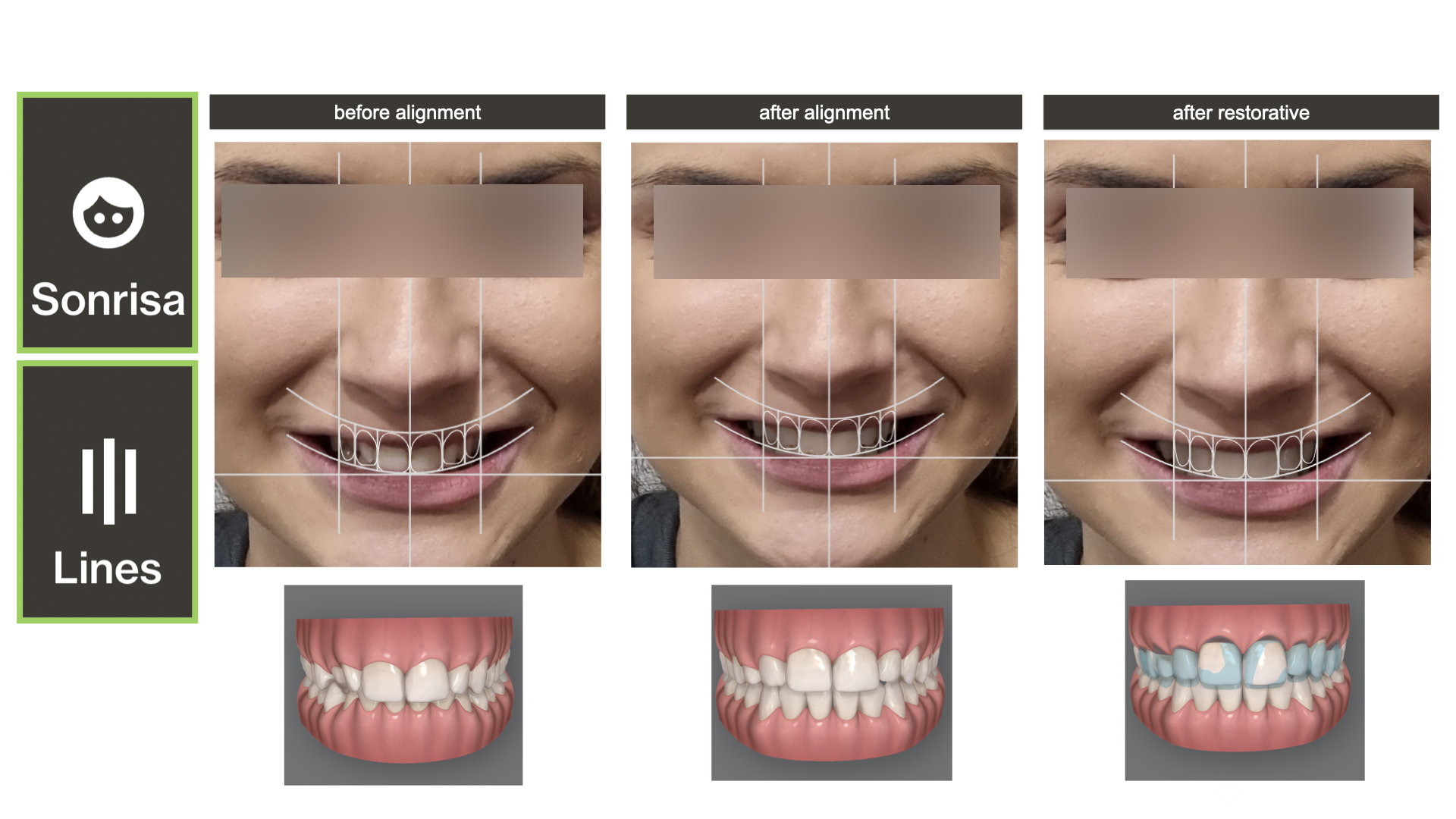 Digital integration with Invisalign Smile Architect