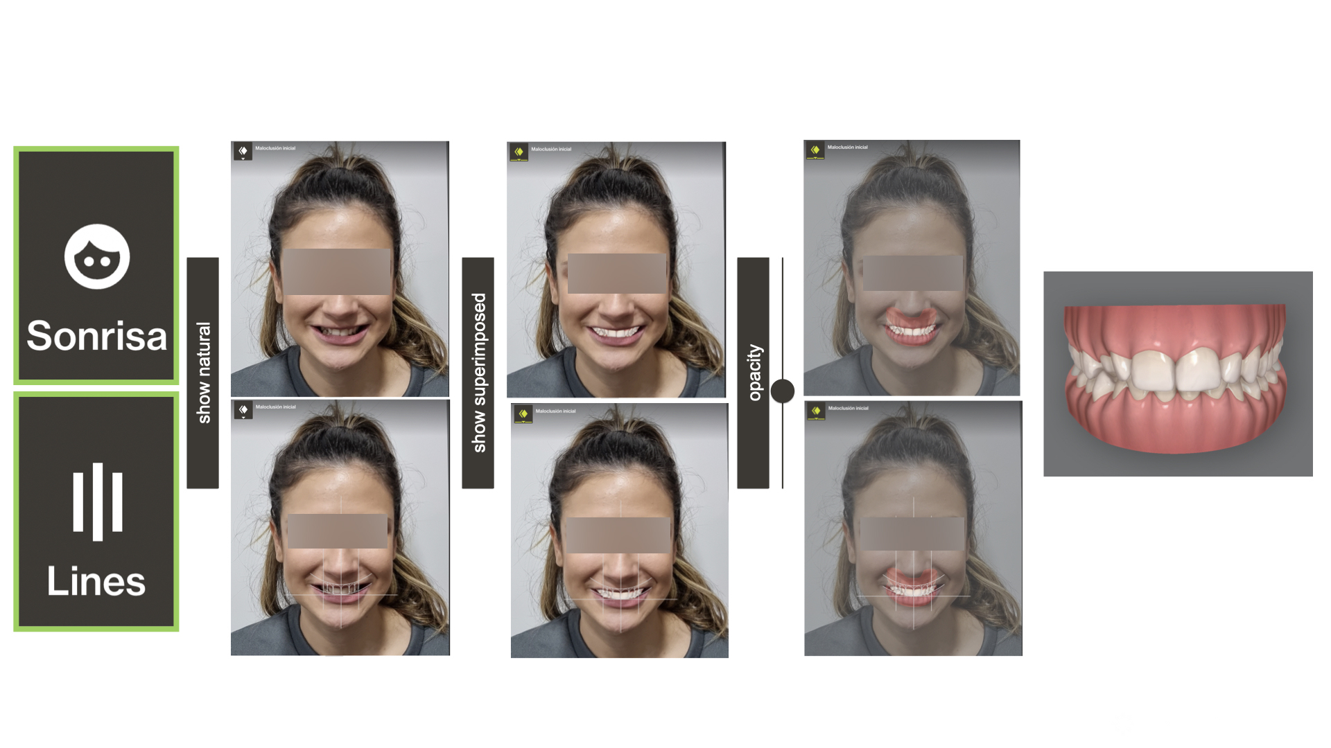 Digital integration with Invisalign Smile Architect