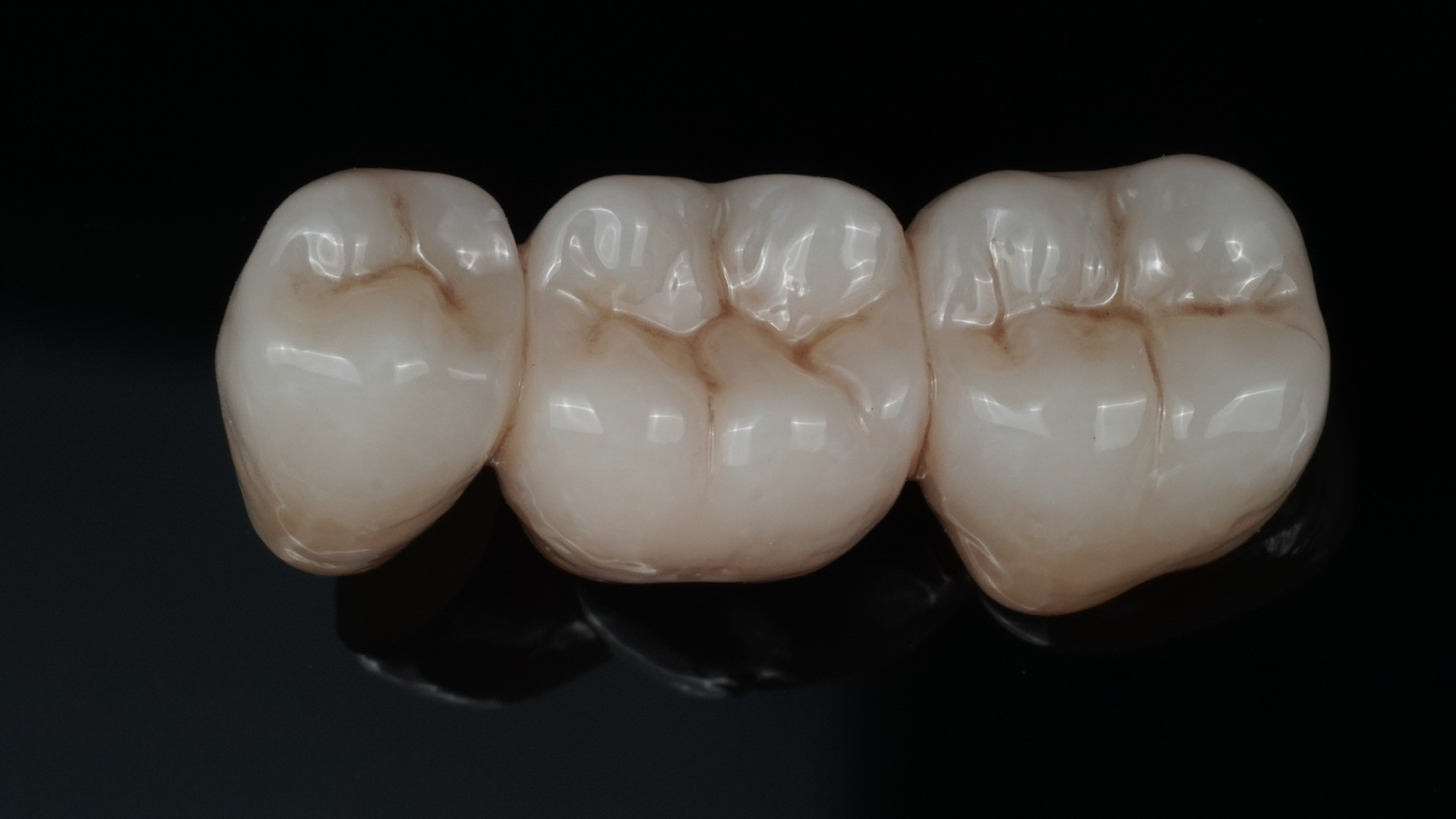 Dental News - Unilateral occlusal elevation with a lithium disilicate ...