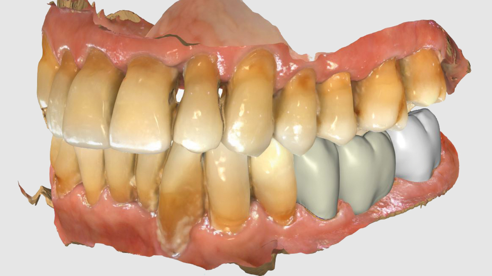 Unilateral occlusal elevation with a lithium disilicate onlay and a ...