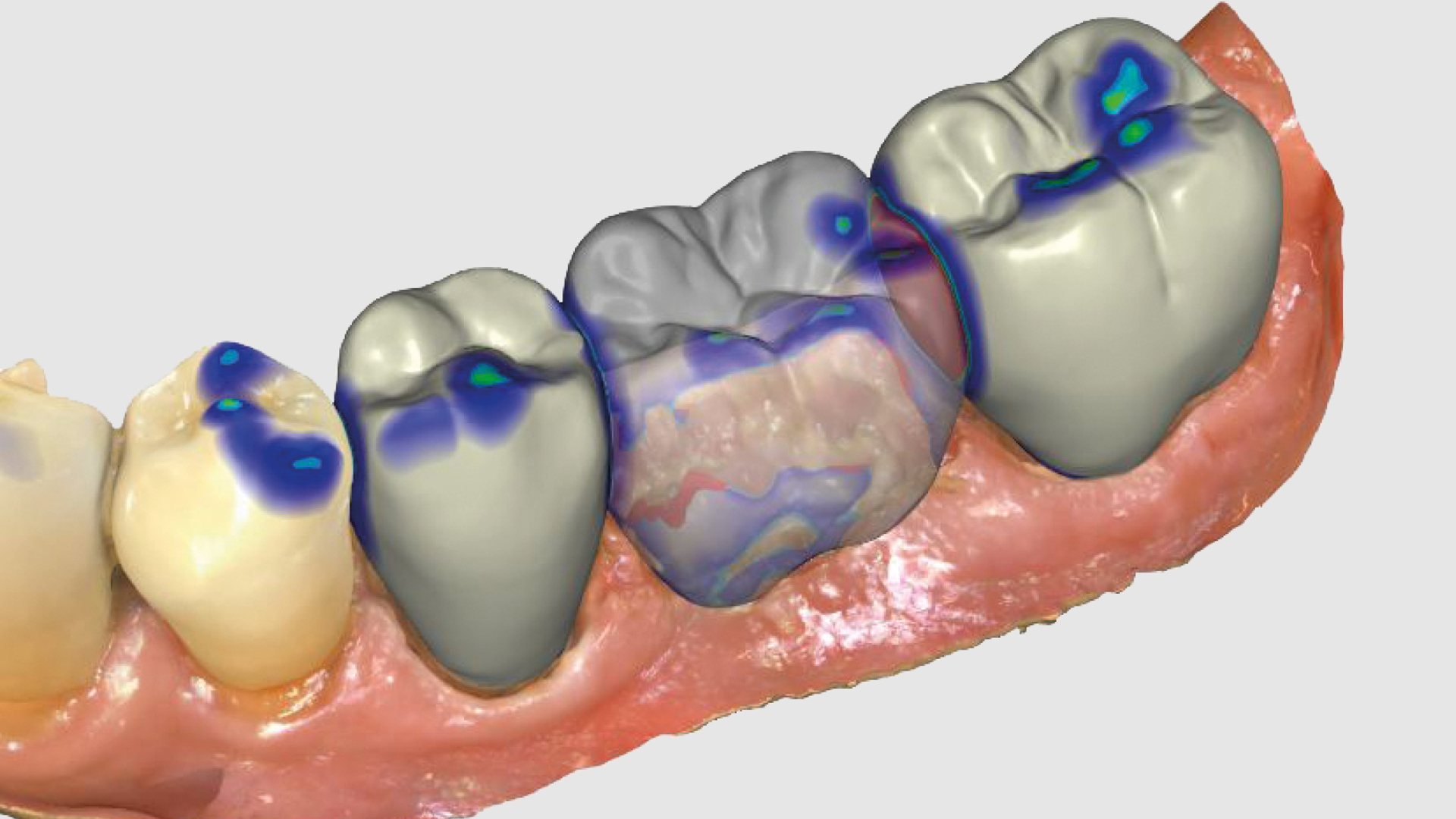 Unilateral occlusal elevation with a lithium disilicate onlay and a ...
