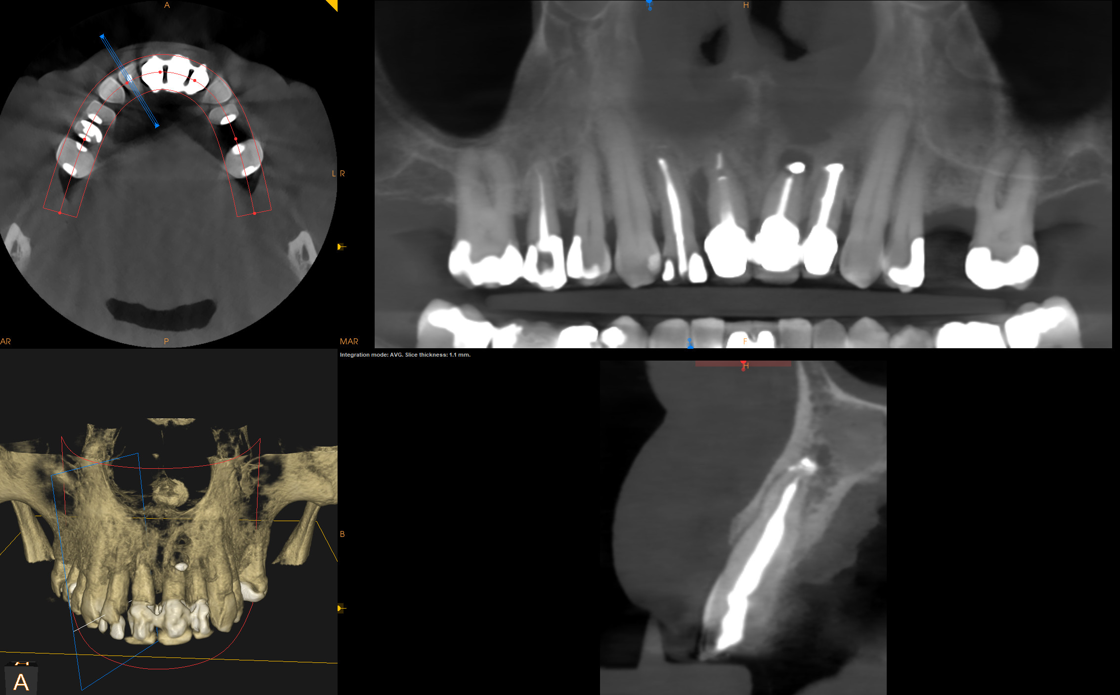 Implant placement with fully guided digital workflow