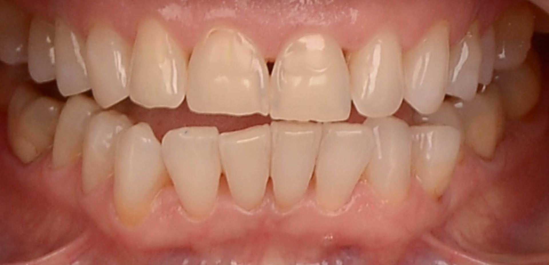 Flowable injection technique—a composite revolution