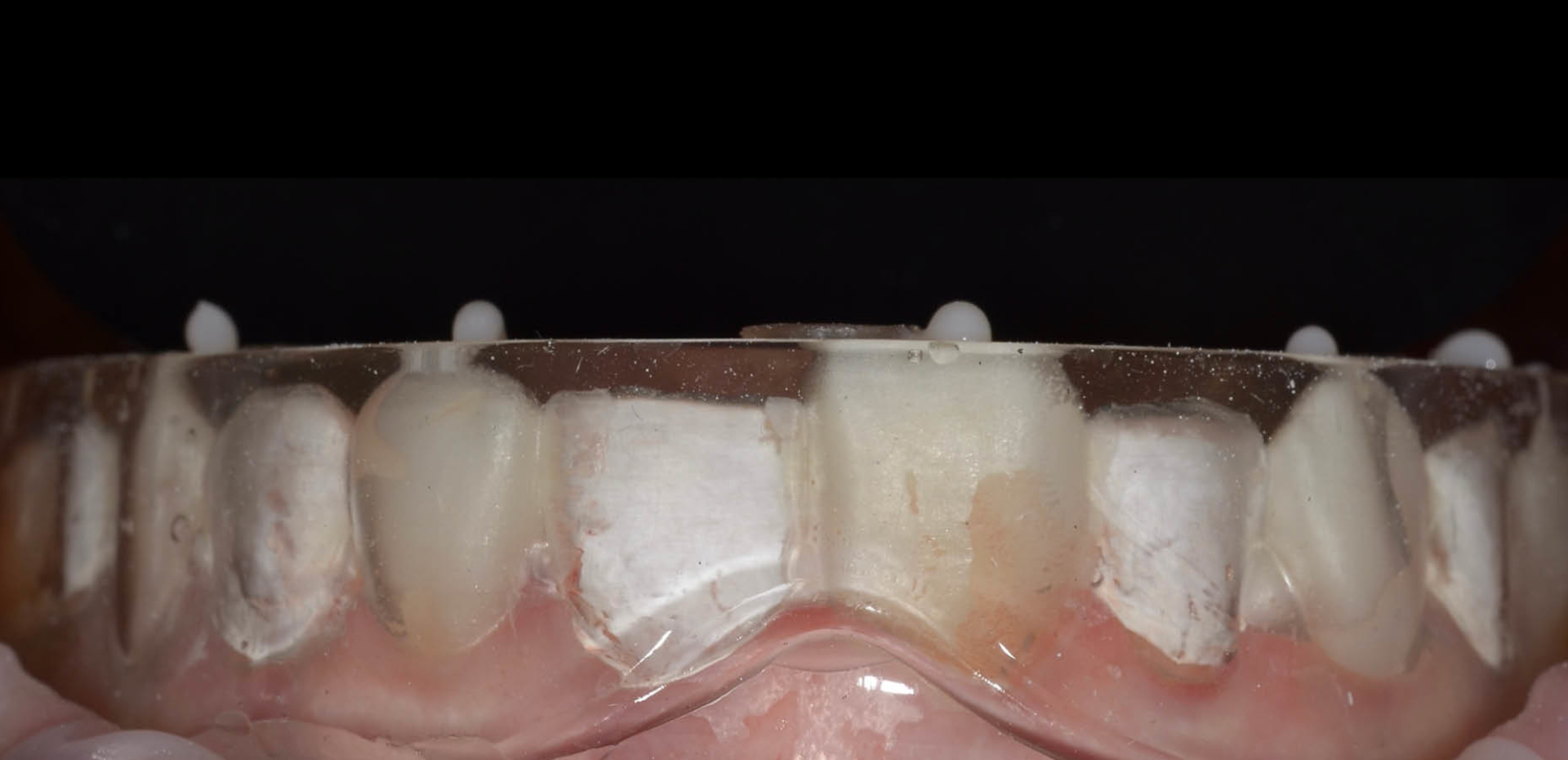 A composite revolution with CLEARFIL MAJESTY ES Flow Low