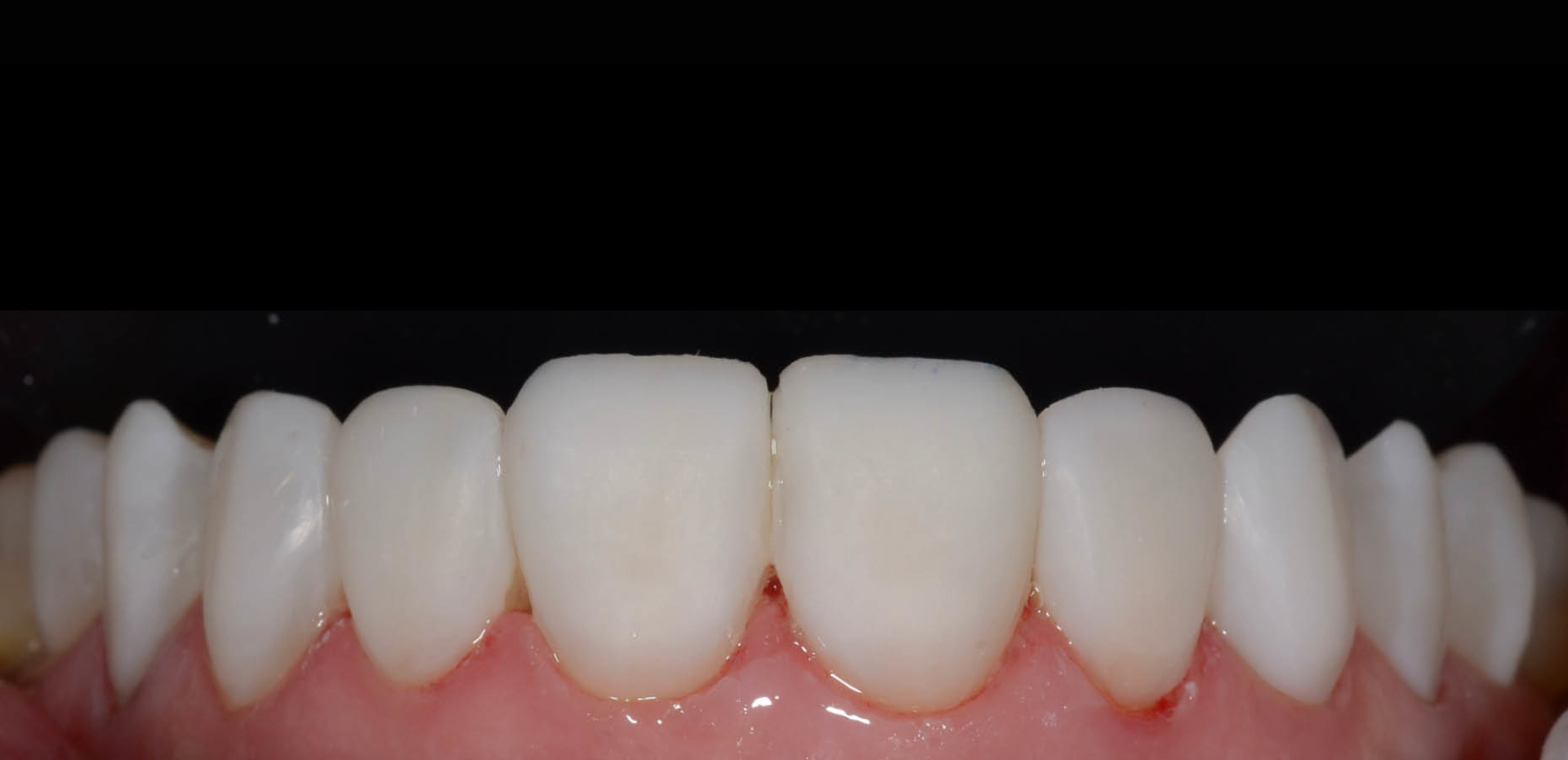 A composite revolution with CLEARFIL MAJESTY ES Flow Low