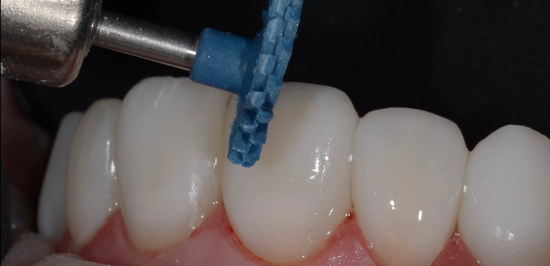 A composite revolution with CLEARFIL MAJESTY ES Flow Low