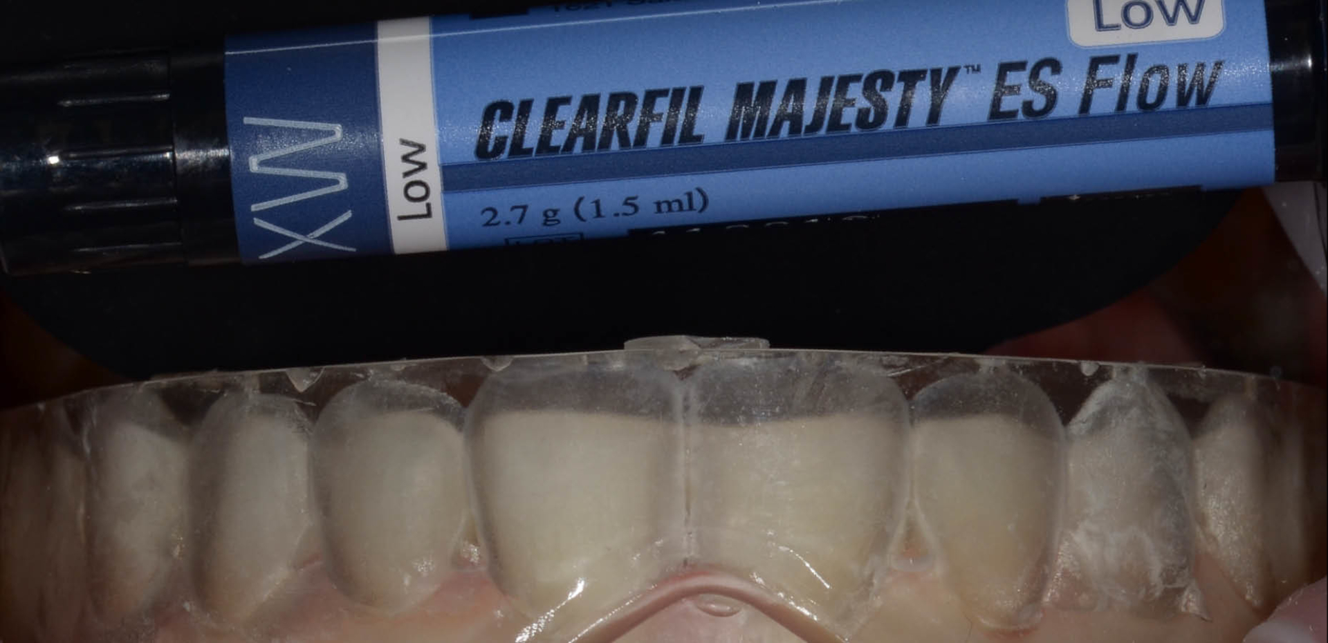 A composite revolution with CLEARFIL MAJESTY ES Flow Low