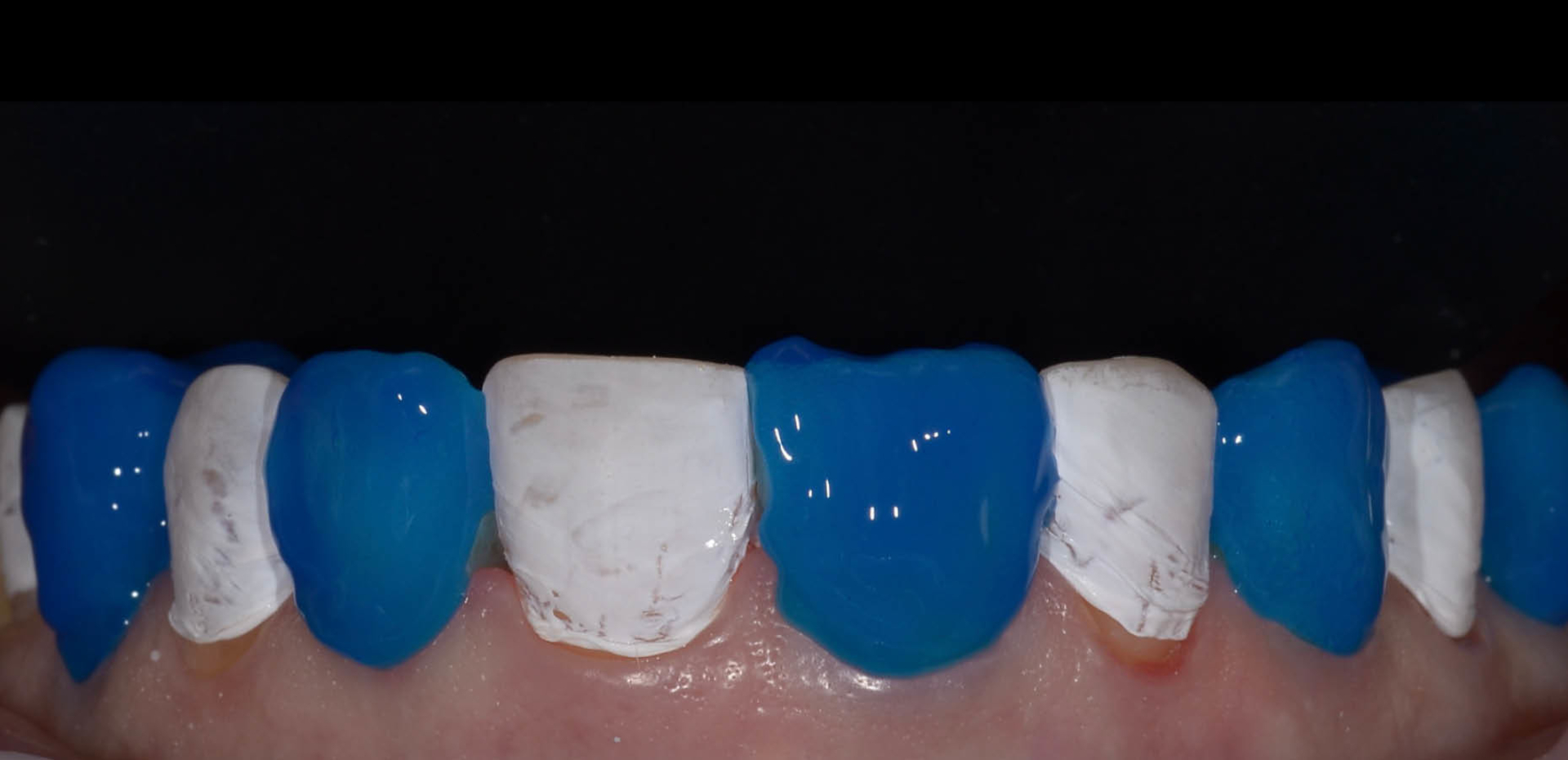 A composite revolution with CLEARFIL MAJESTY ES Flow Low