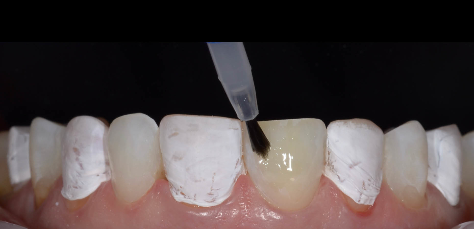 Flowable injection technique—a composite revolution