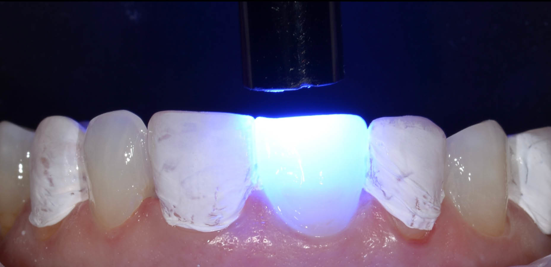 A composite revolution with CLEARFIL MAJESTY ES Flow Low