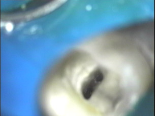 Dental News - On the pulse of endodontics—the key role of new ...