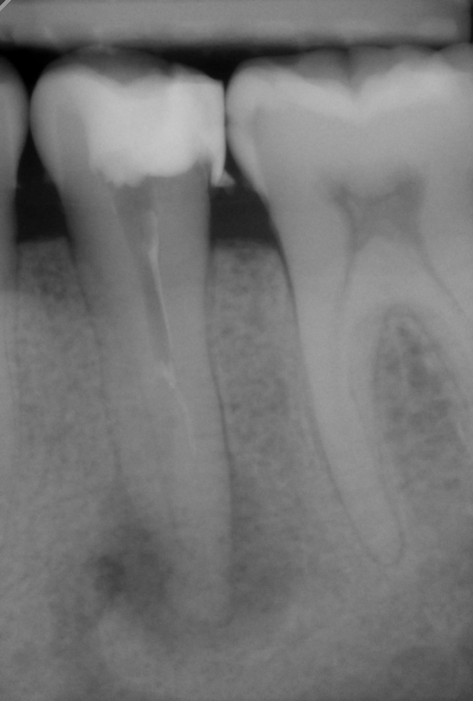 Dental News - On the pulse of endodontics—the key role of new ...