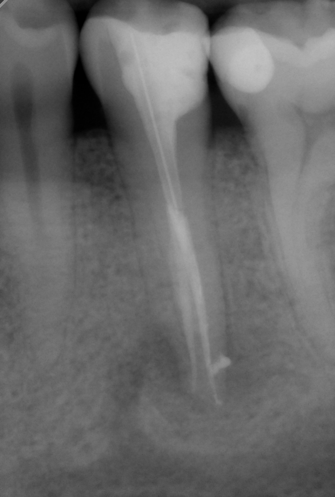 Dental News - On the pulse of endodontics—the key role of new ...
