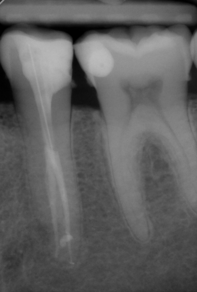 Dental News - On the pulse of endodontics—the key role of new ...
