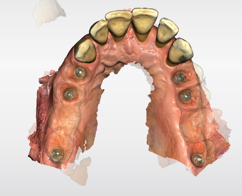 Immediate loading of the posterior maxilla