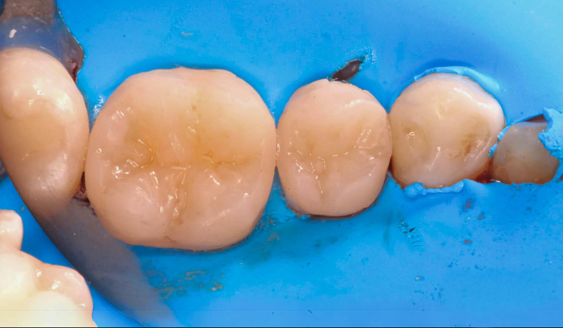 How to polish a composite restoration in posterior area
