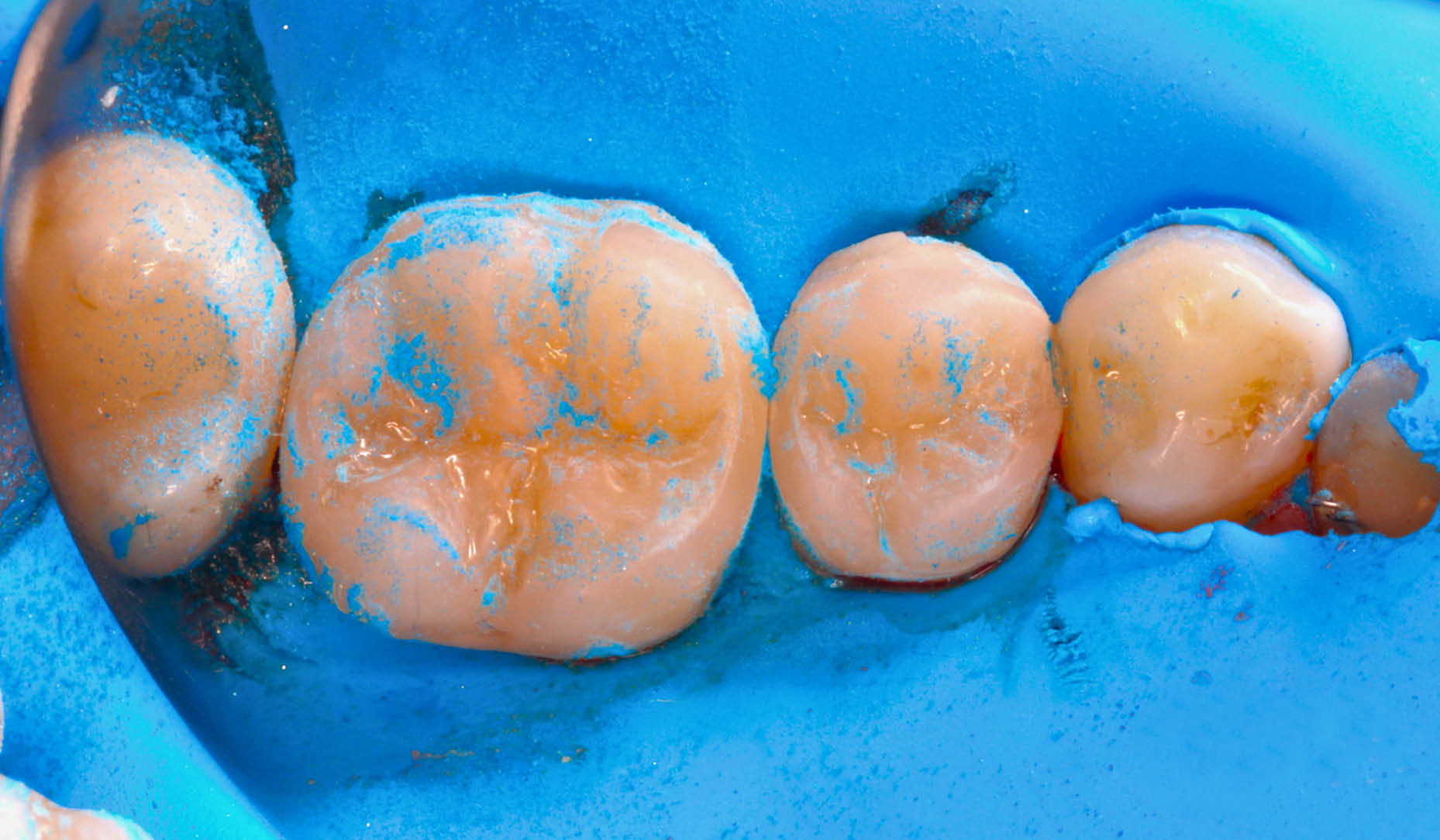 How to polish a composite restoration in posterior area