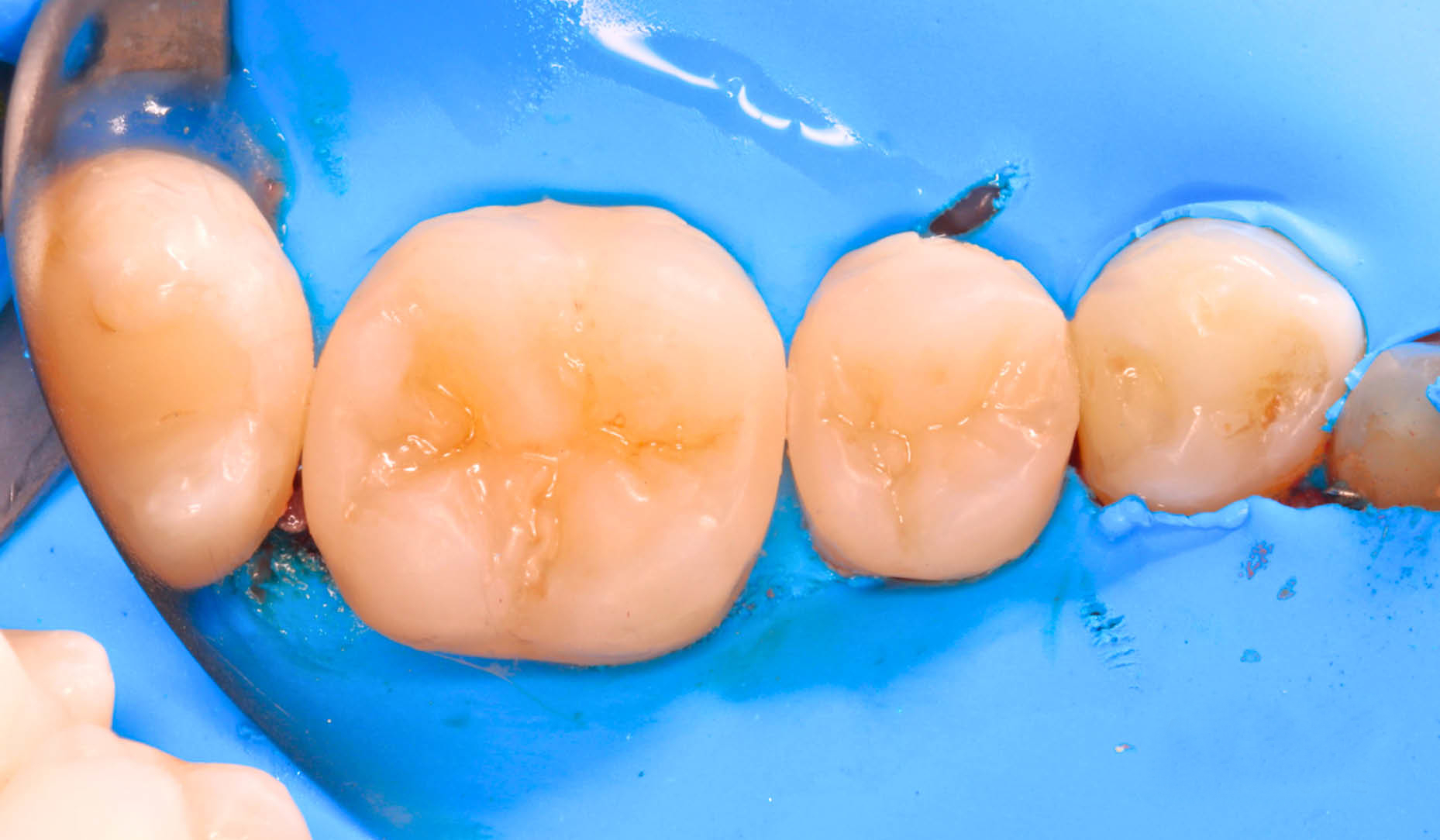 How to polish a composite restoration in posterior area