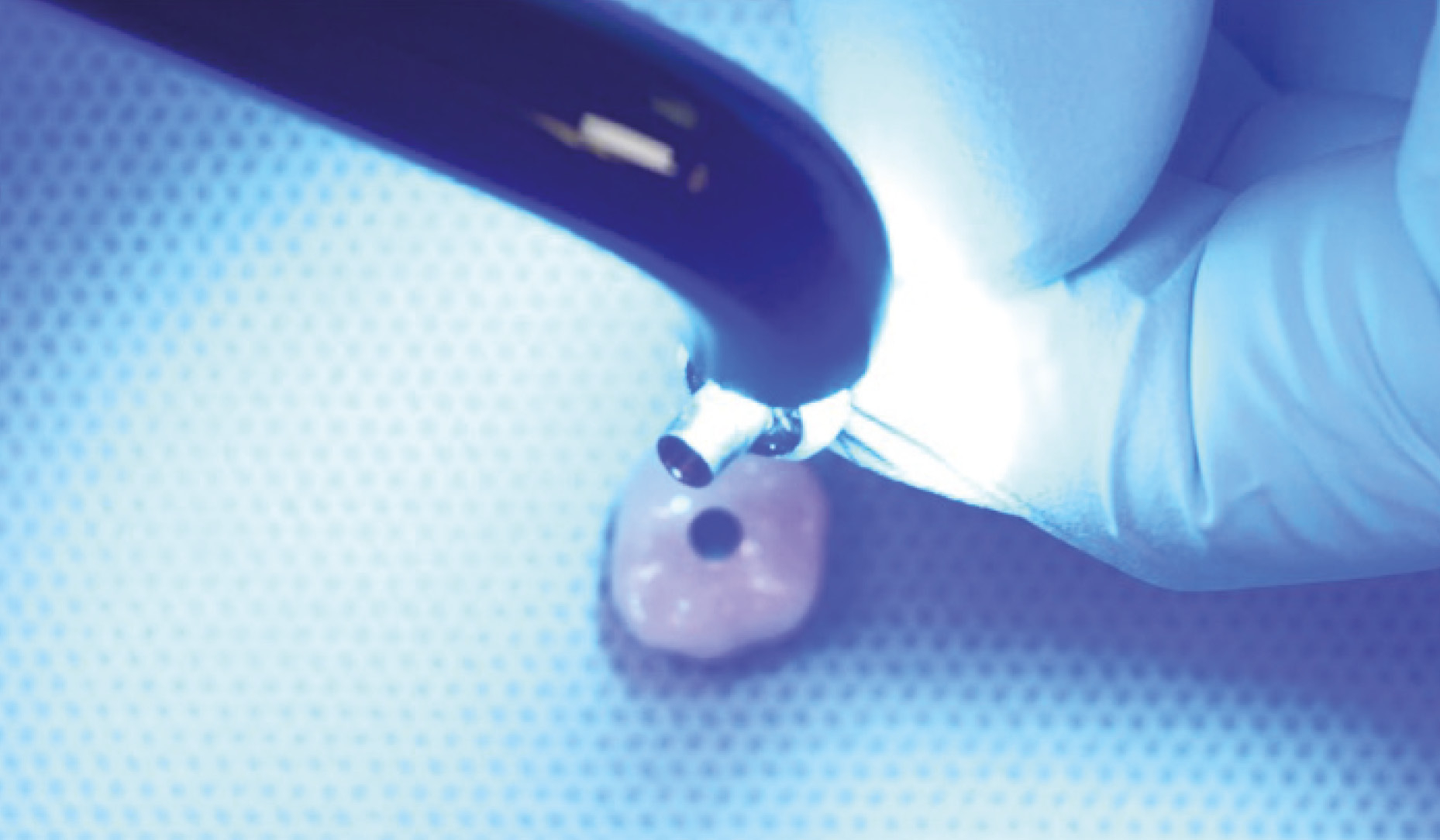 Titanium base implant cementation technique