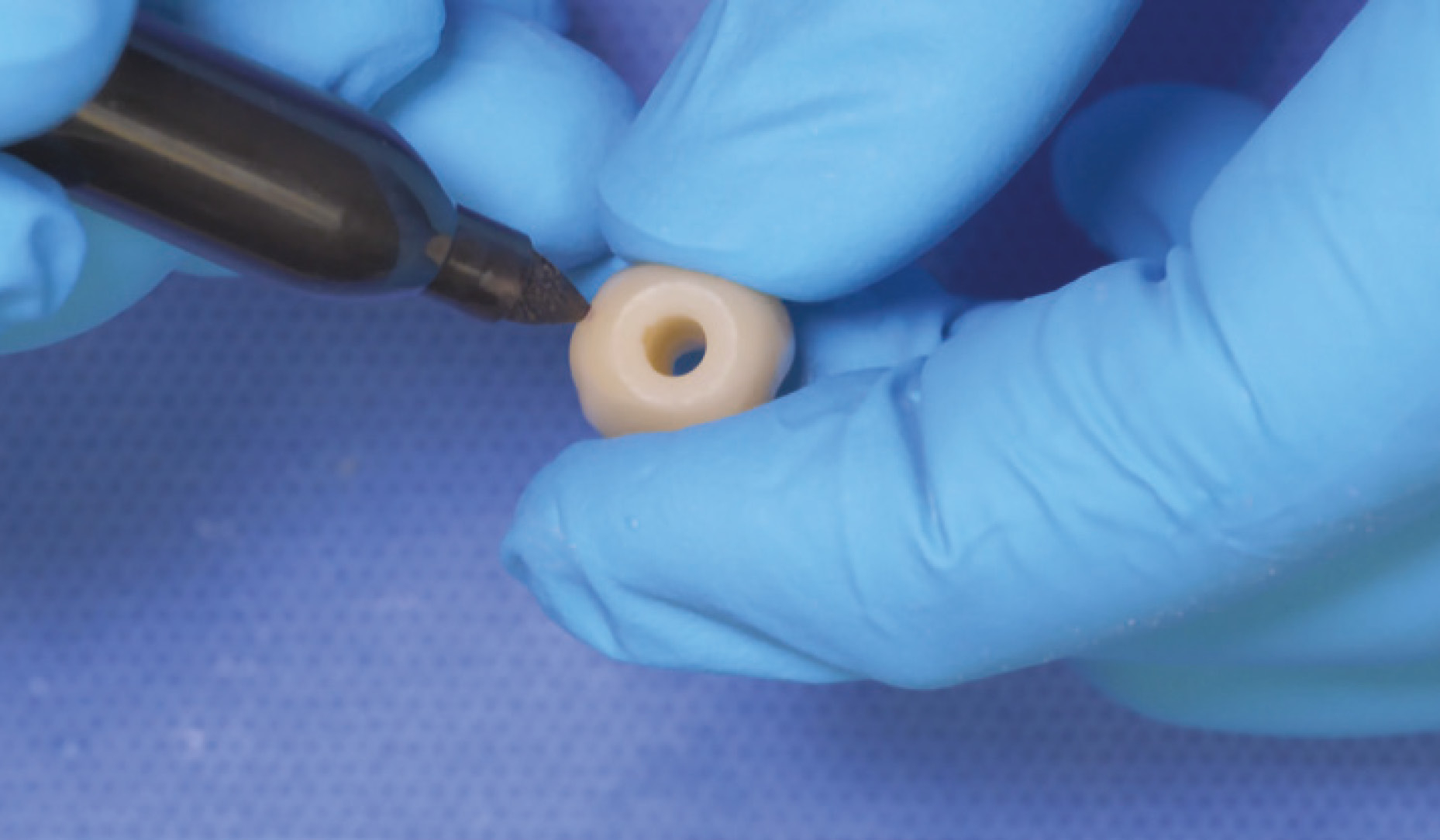 Titanium base implant cementation technique