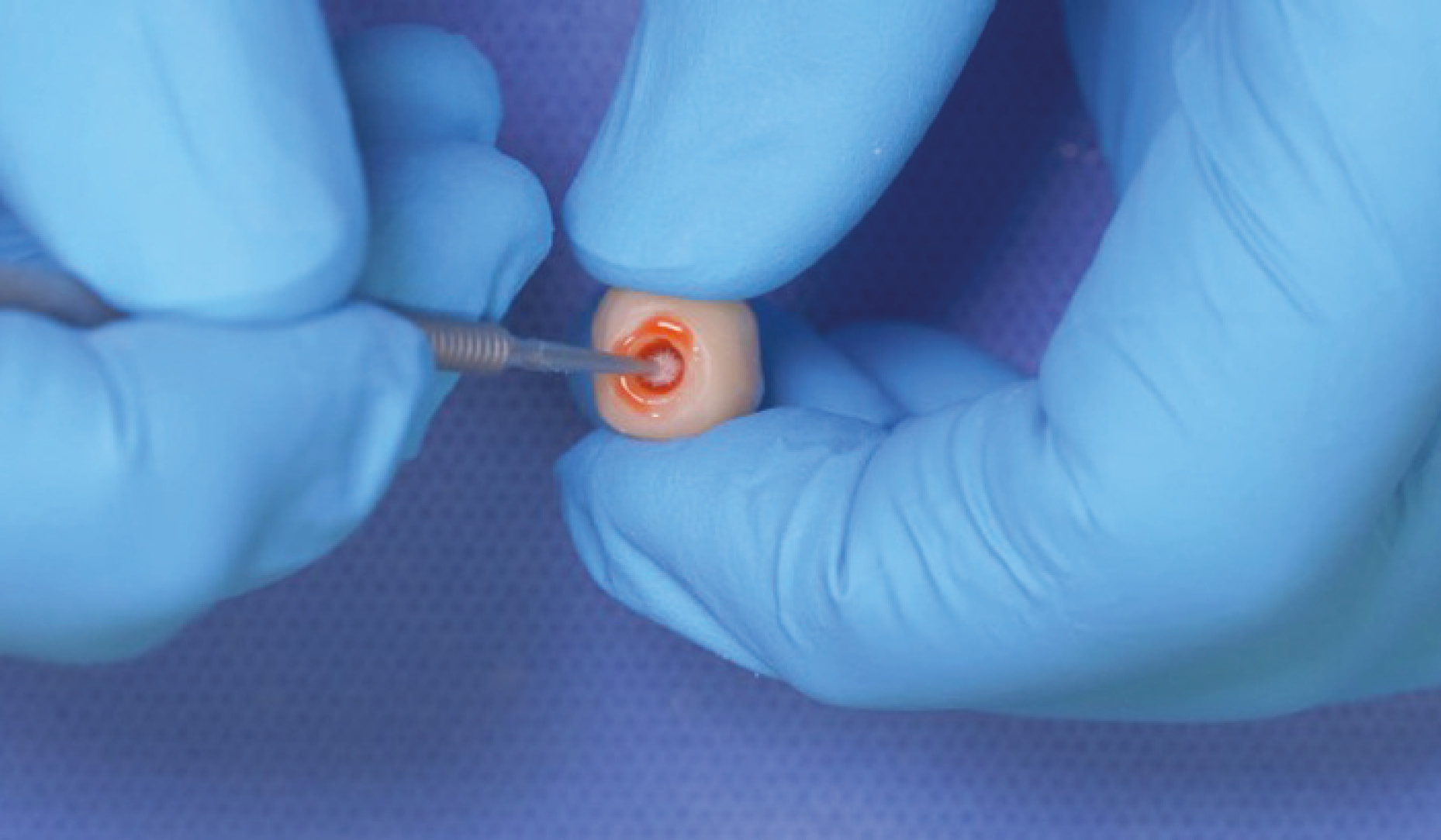 Titanium base implant cementation technique