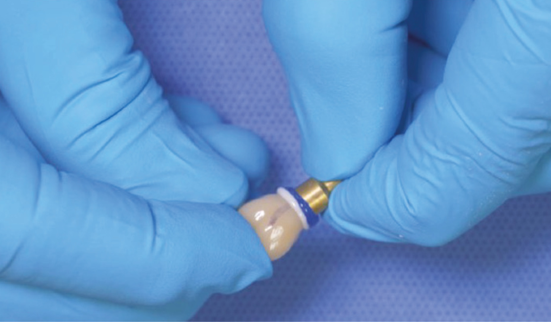 Titanium base implant cementation technique