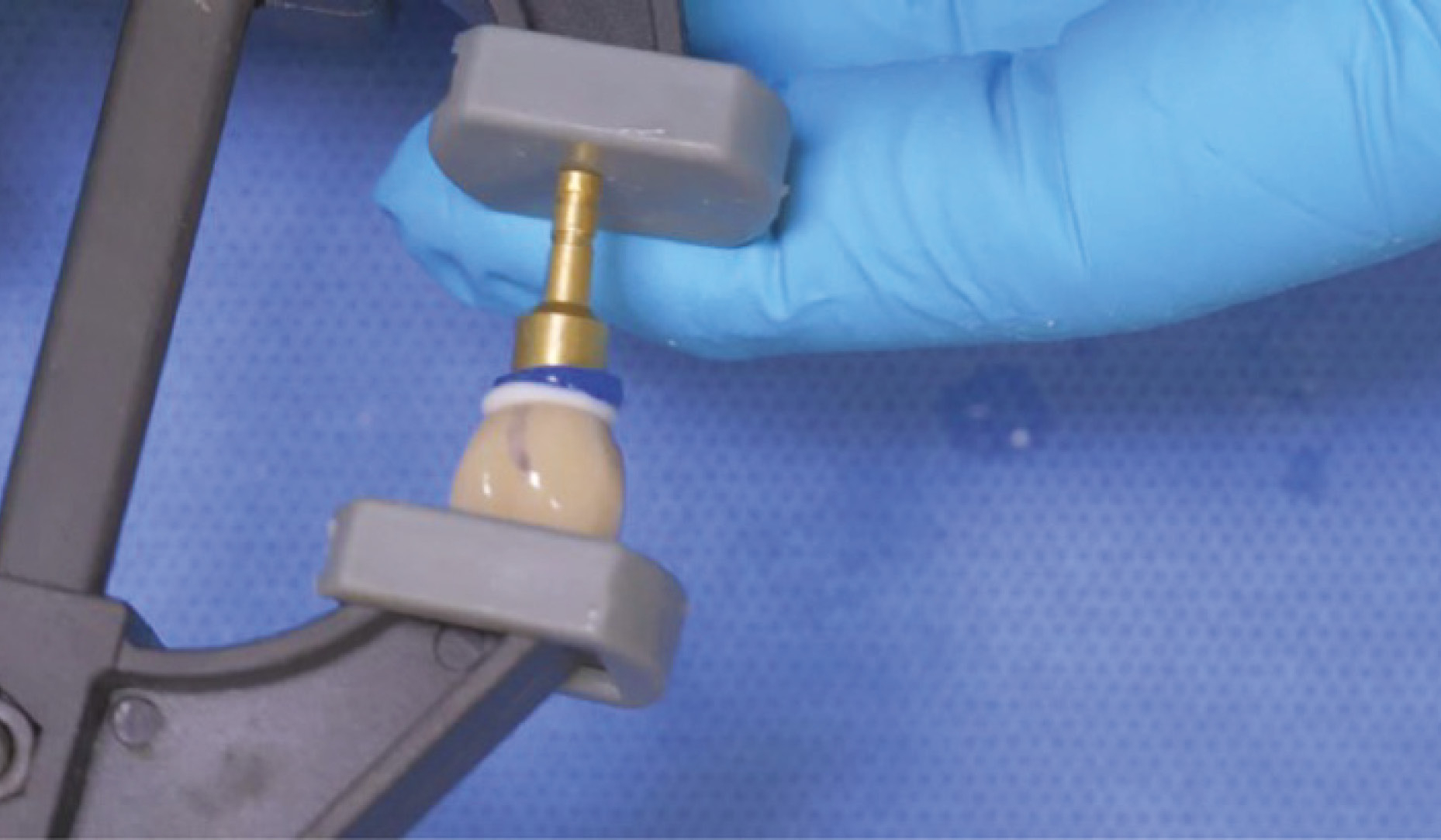 Titanium base implant cementation technique