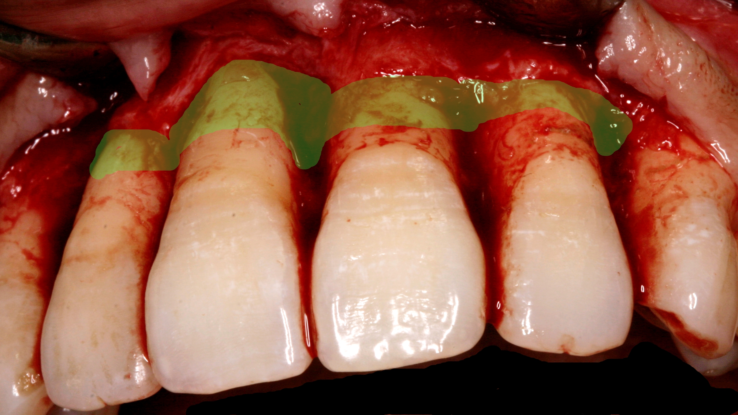 DT News - India - Contour augmentation for periodontal defects (CAPD ...