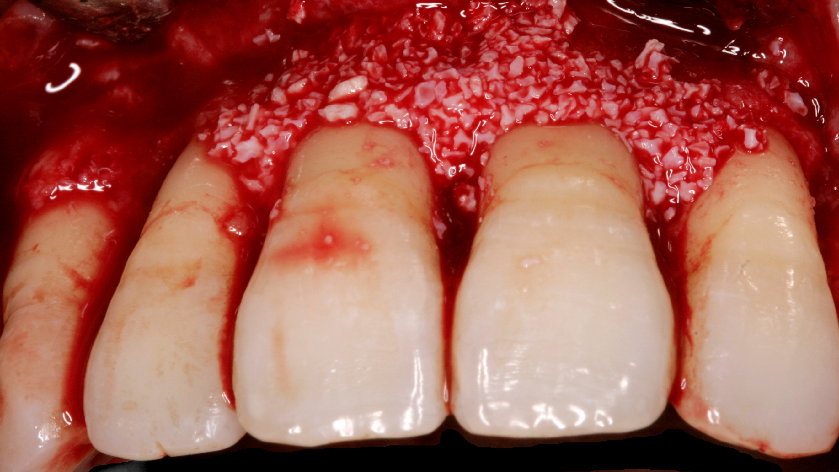 DT News - India - Contour augmentation for periodontal defects (CAPD ...