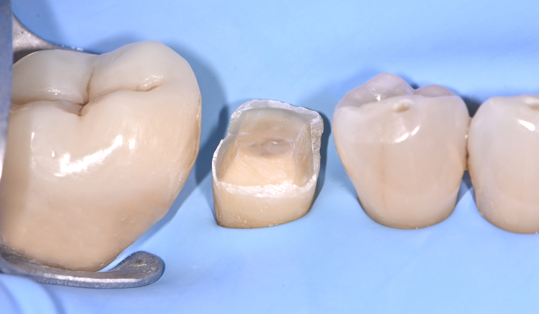 Amalgam replacement using hybrid ceramics