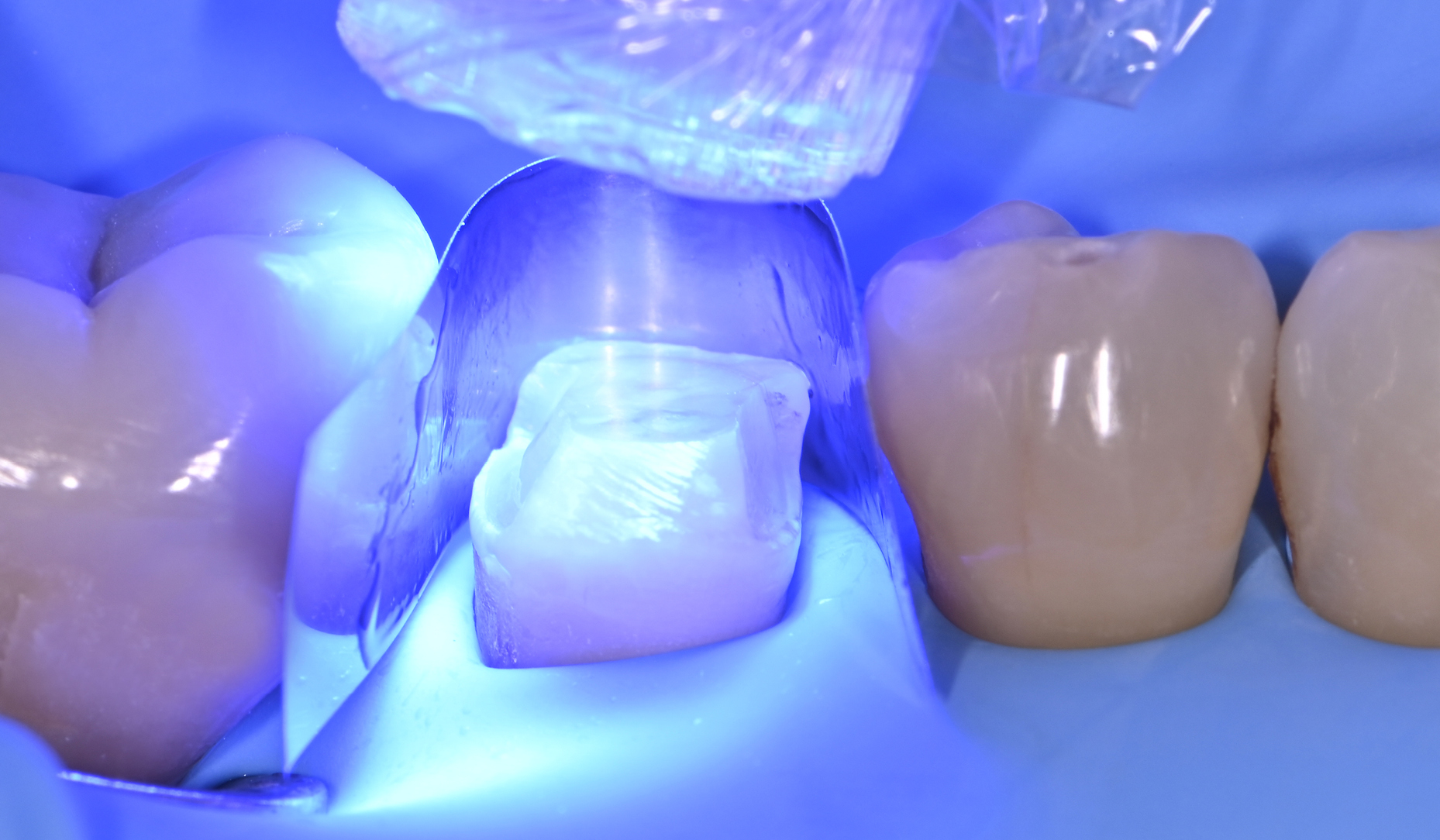 Amalgam replacement using hybrid ceramics