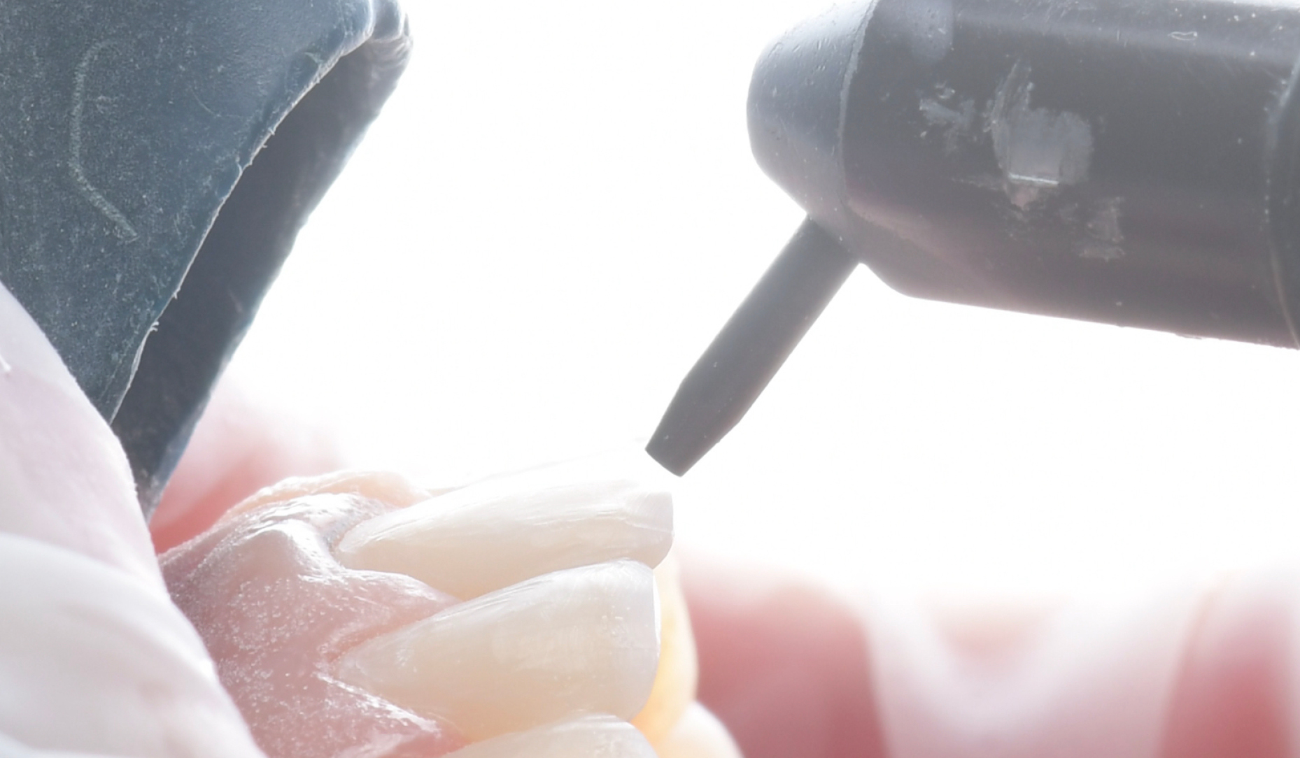 Tips and tricks for bonding in minimally invasive repair pro