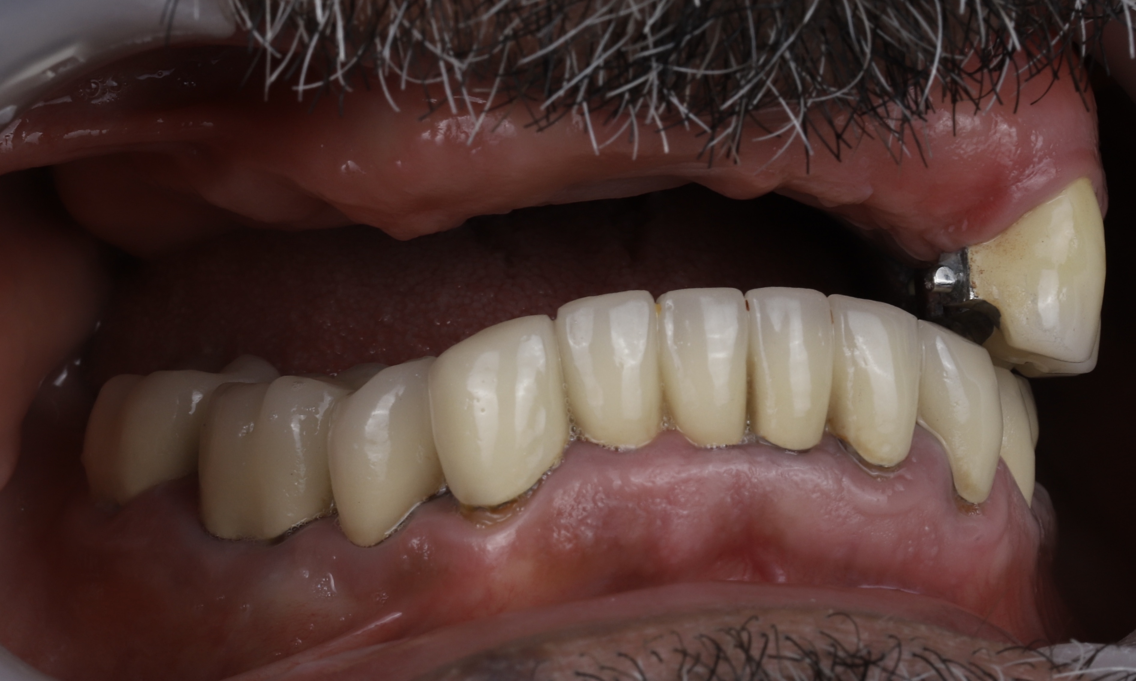 Case report: Digital workflows in full-arch rehabilitation